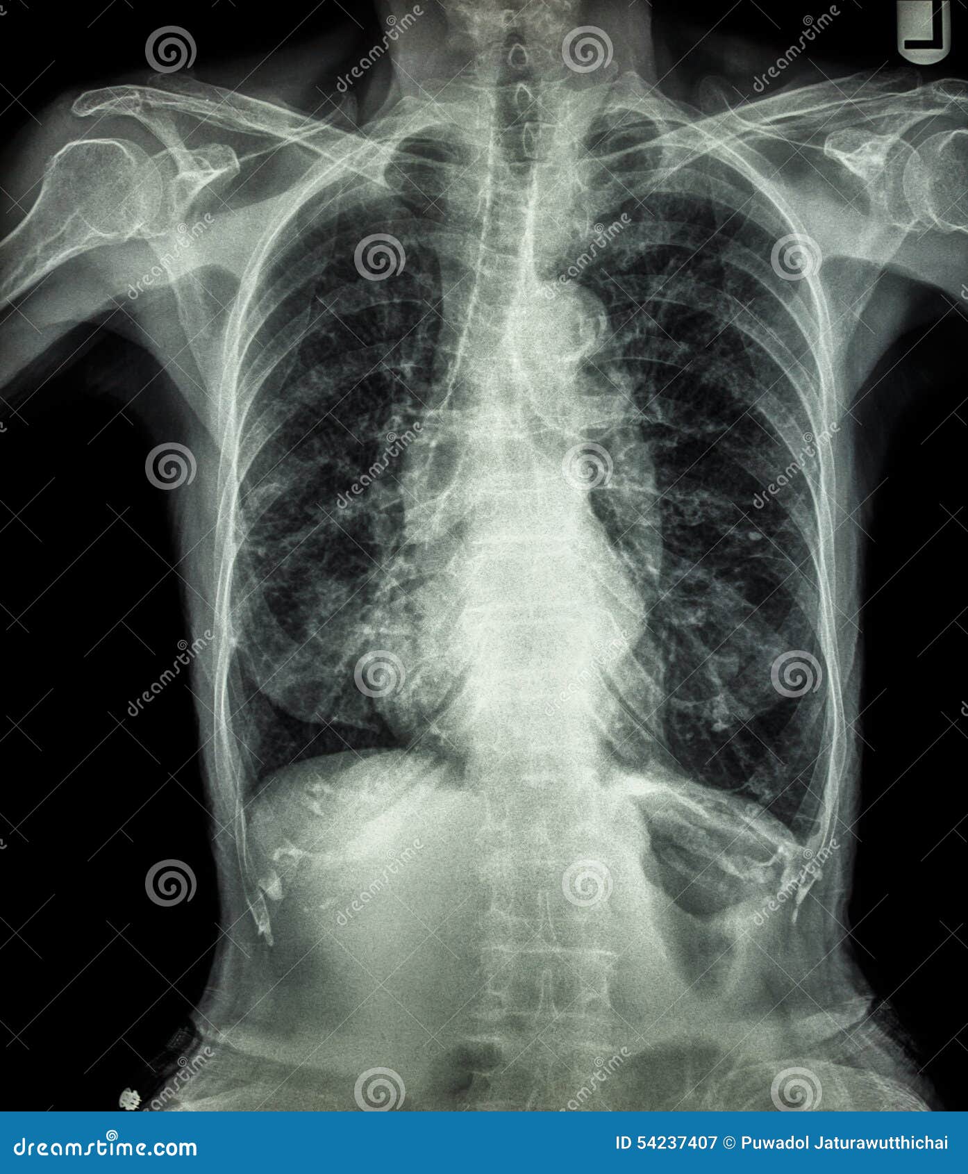 Chest X-ray of Old Patient ( Calcification at Rib , Trachea , Bronchus ...