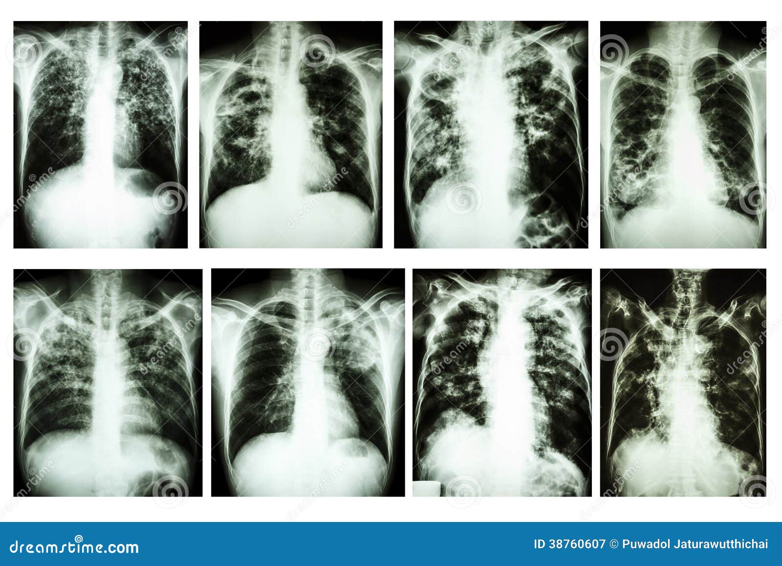 Chest X-ray Pulmonary Tuberculosis Stock Image - Image of heart ...