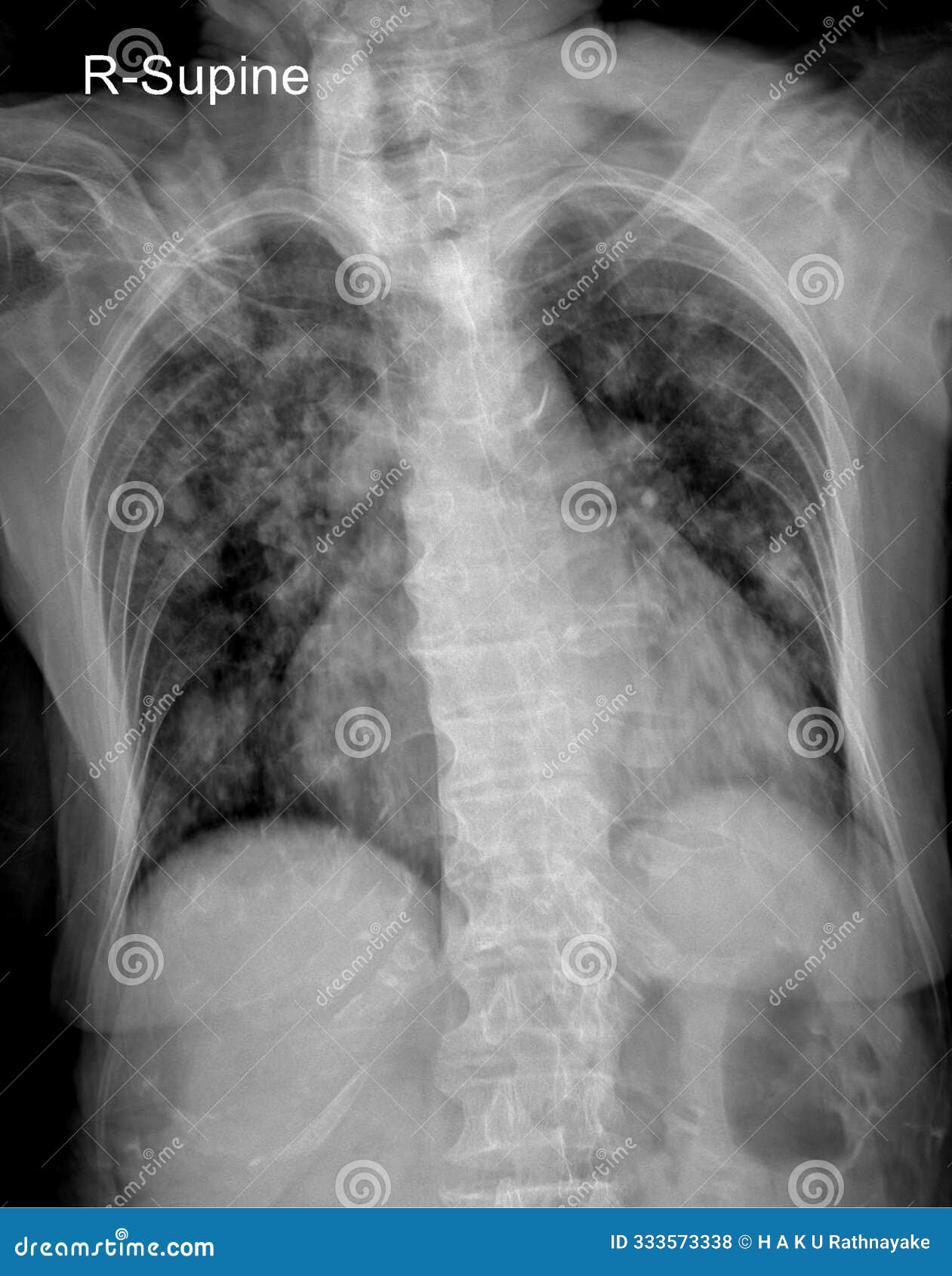 Chest X-Ray: a Radiographic Technique for Evaluating Thoracic ...
