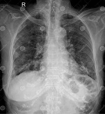Chest X-Ray: a Radiographic Technique for Evaluating Thoracic ...