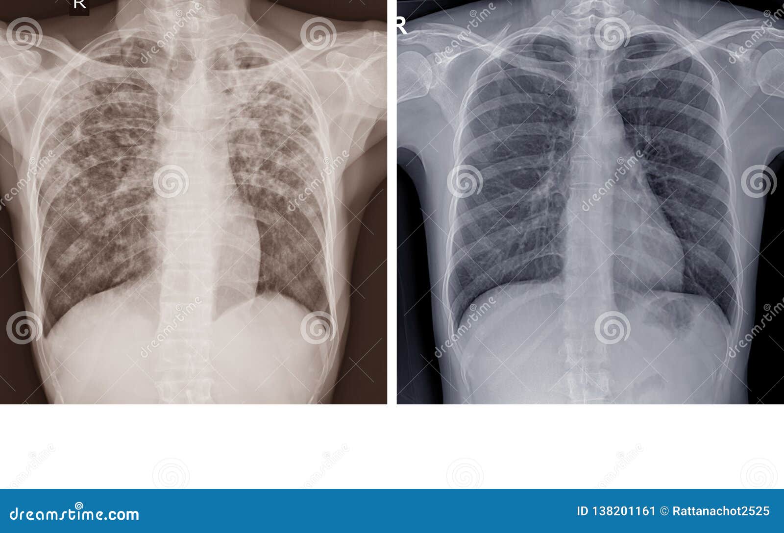 Chest X-ray Showing Normal Chest and Pulmonary Tuberculosis TB Stock ... Chest X-ray Showing Normal Chest and Pulmonary Tuberculosis TB Stock ...