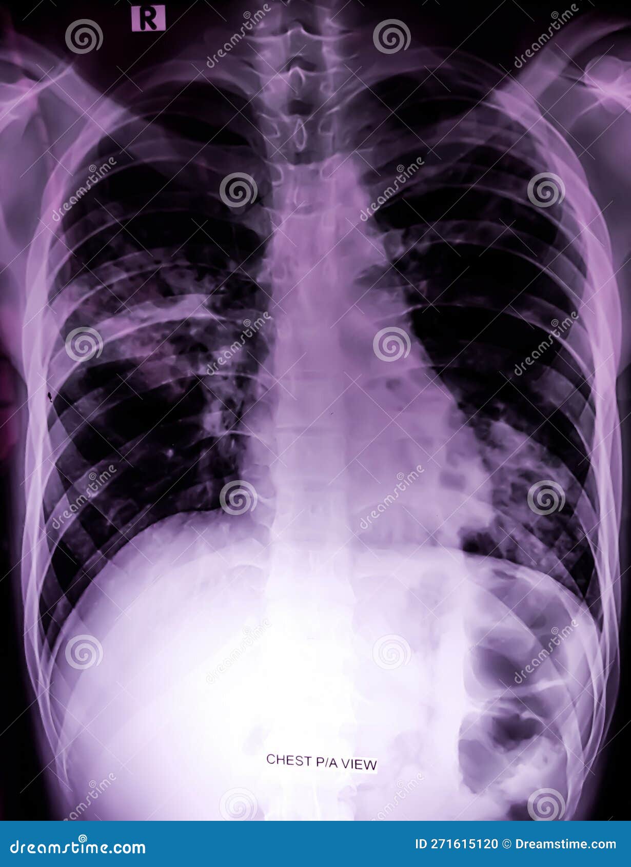 Chest X-ray Showing Patchy Opacification. Stock Photo - Image of health ...