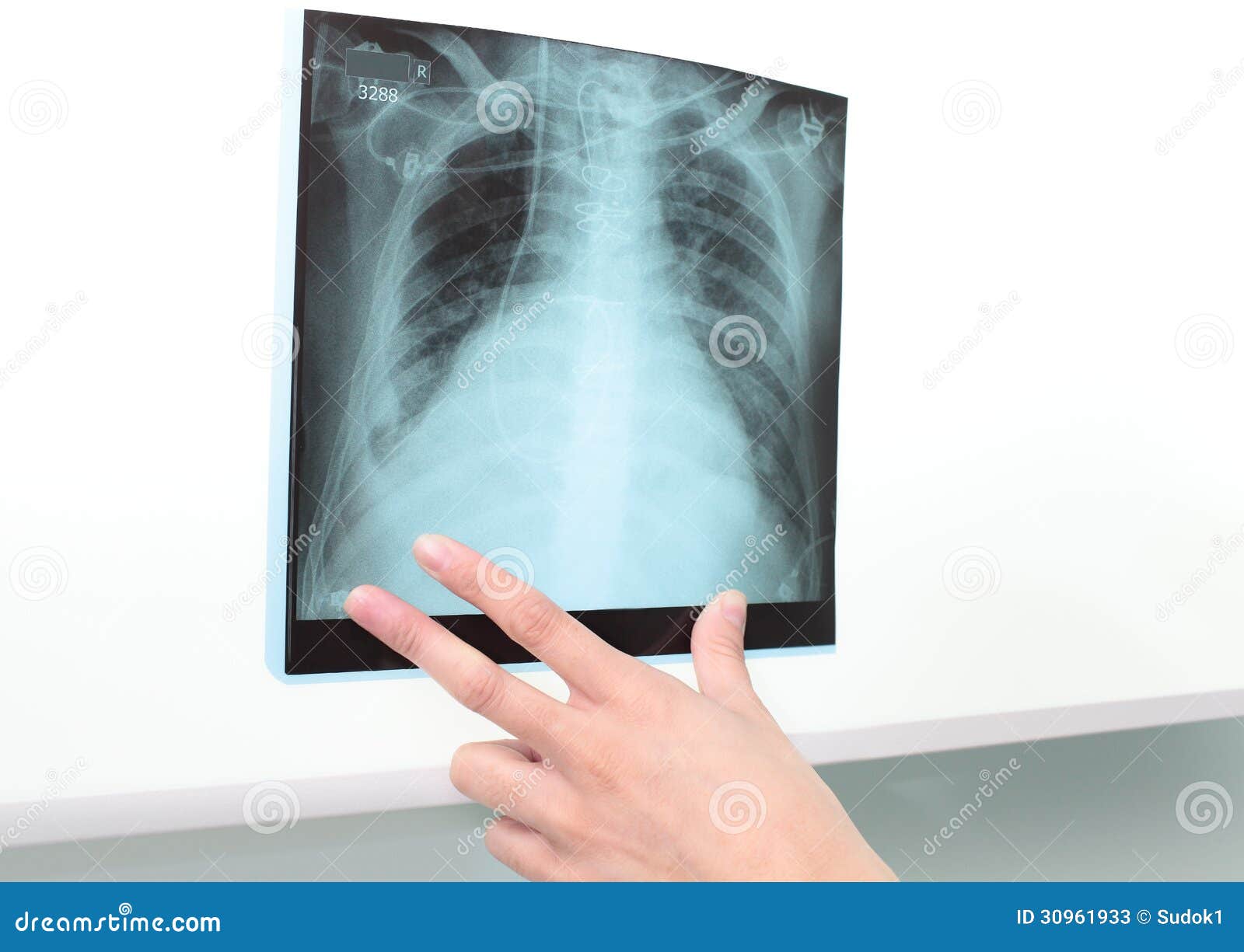Chest X-ray To Negatoscope. Stock Image - Image of laboratory, backache ...