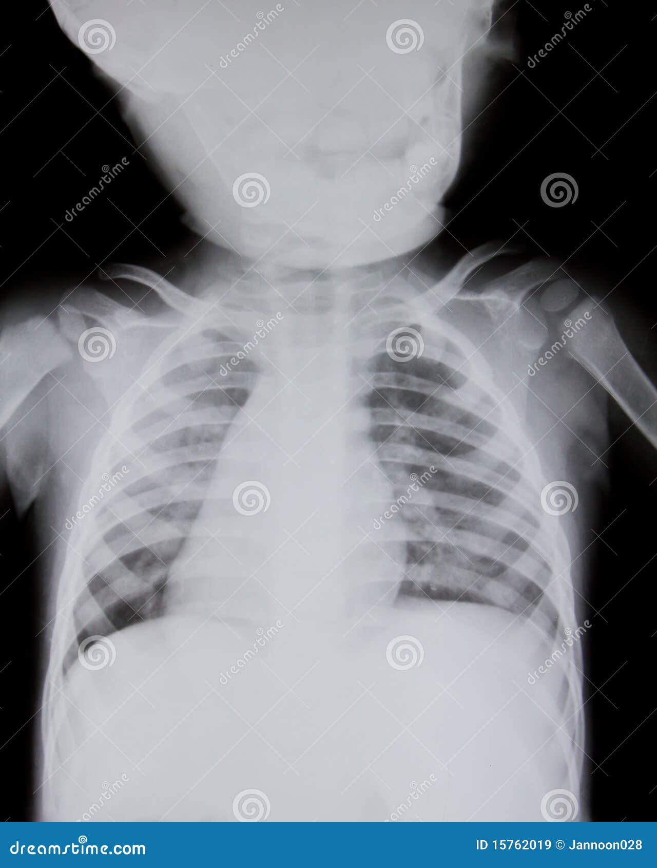 Chest x-ray of young boy. stock image. Image of children - 15762019