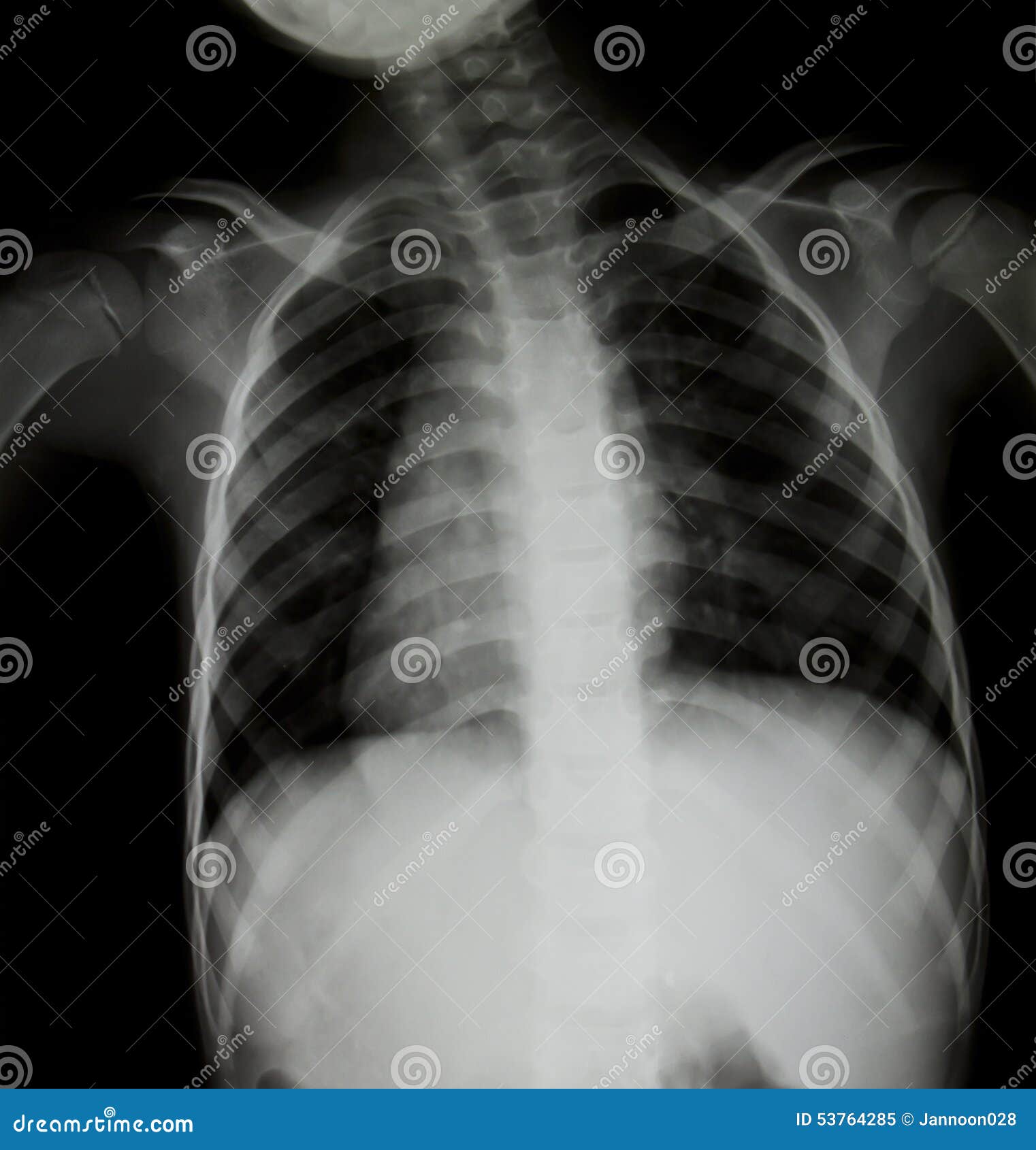 Chest X Ray Asthma