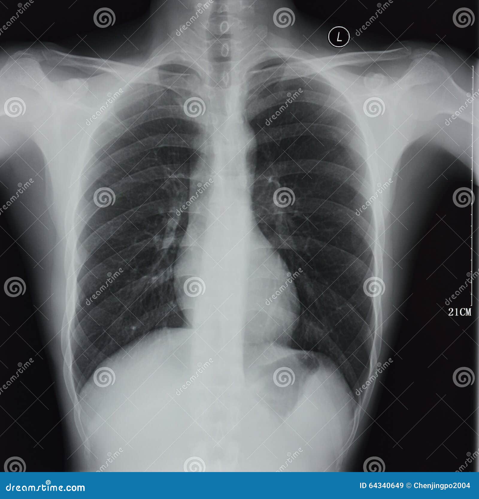 Chest X-rays stock image. Image of diagnose, lung, human - 64340649