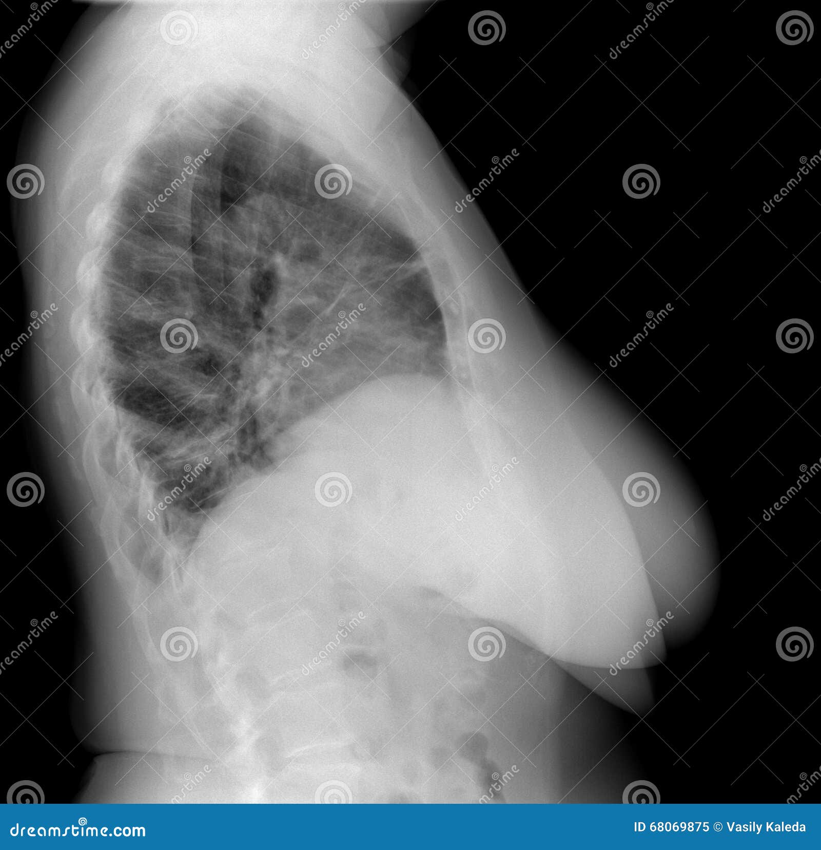 Chest roentgenogram stock image. Image of xray, bone - 68069875
