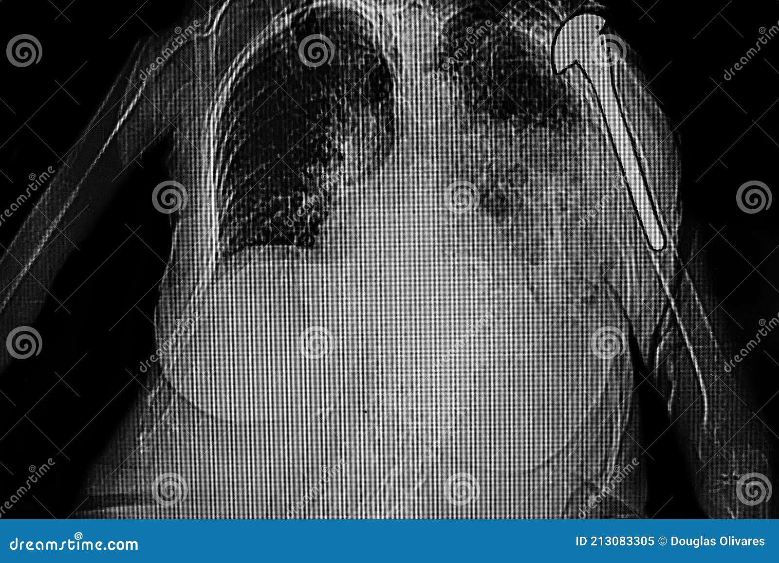 Chest RX Patient with Left Humerus Prosthesis and Left Side Diaphragm ...