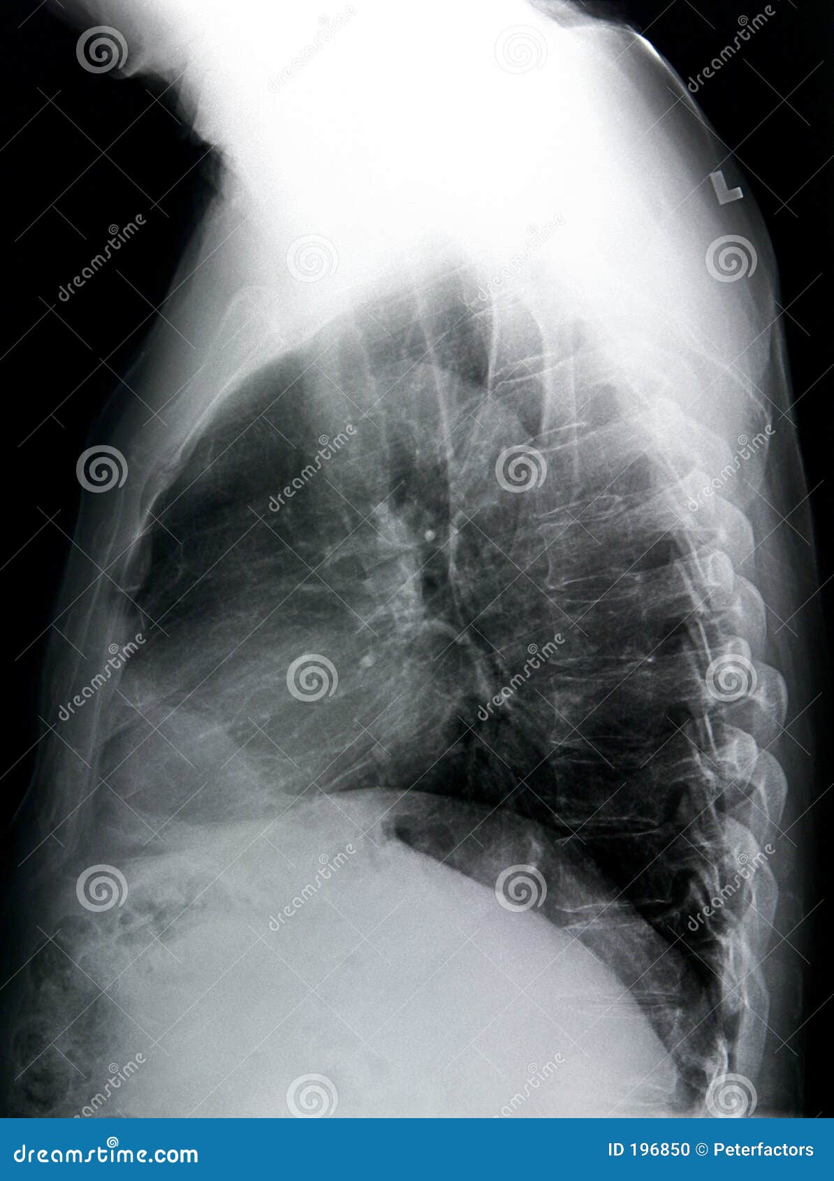 Chest side stock photo. Image of life, negative, illness - 196850