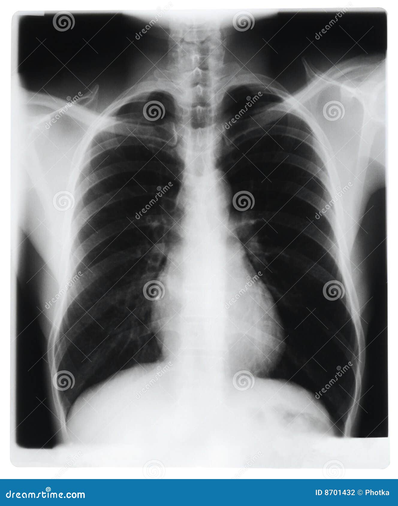 Chest X-ray Stock Photography - Image: 8701432