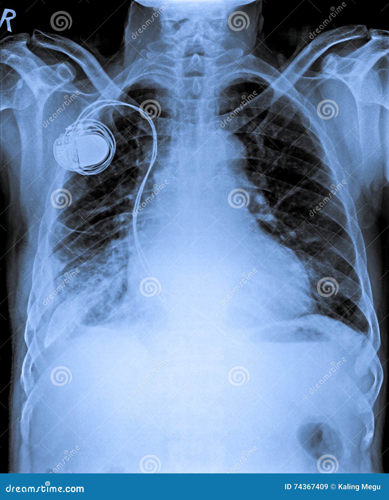 Pacemaker Showing In Chest X-ray Stock Image | CartoonDealer.com #134286589