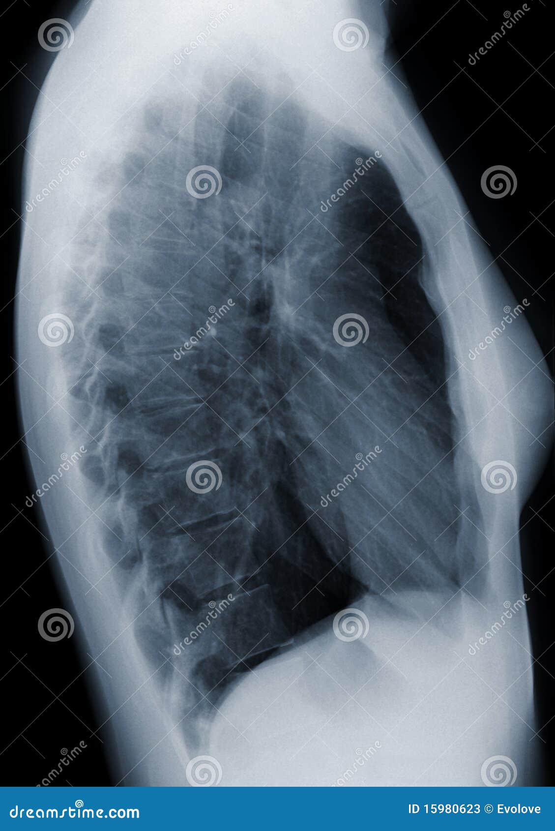 Chest X-Ray Side Stock Photos - Image: 15980623