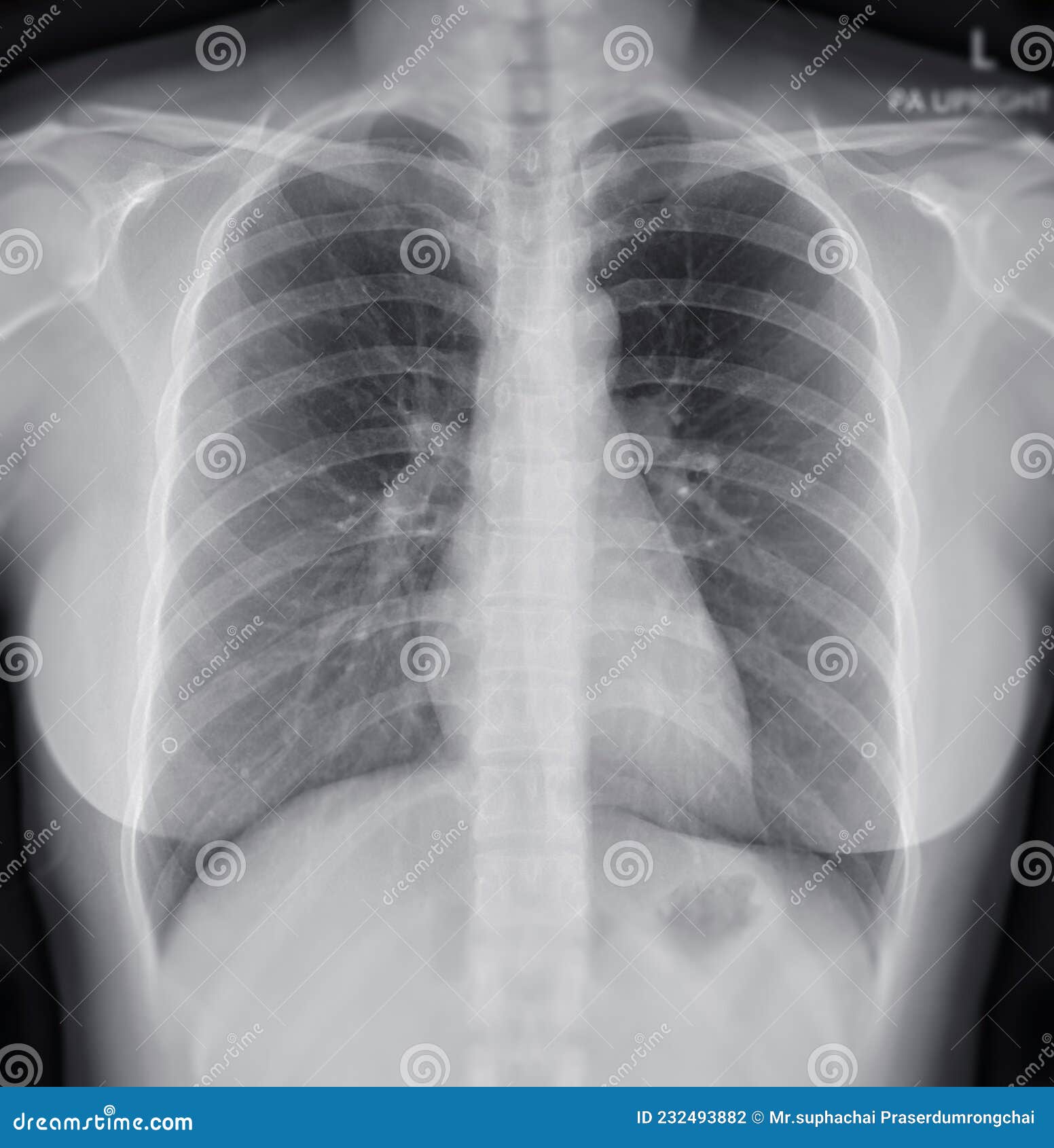 X-ray Lung. Showing A Large Infiltrate In The Middle Lobe Of The Right ...