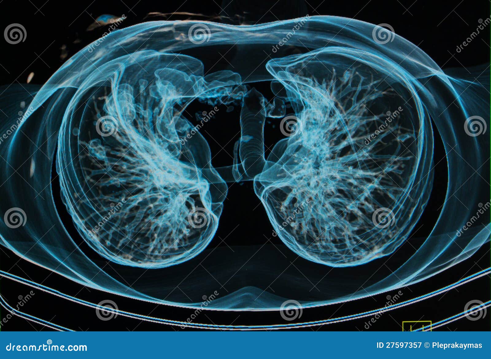 Chest X-rays In Upright Position For Medical Study And Learning. Easily ...