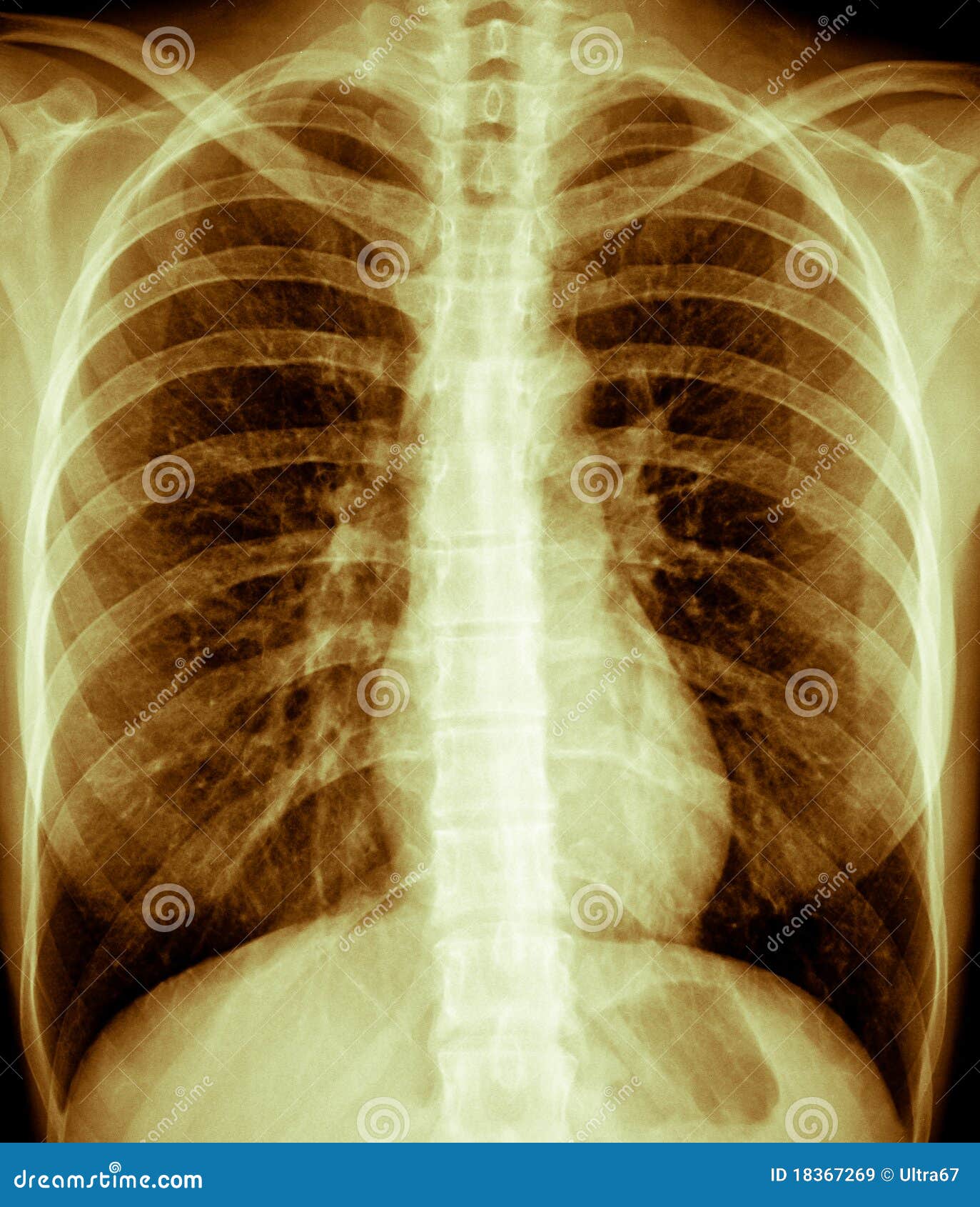 Chest Xray,Female stock image. Image of hospital, exam - 18367269