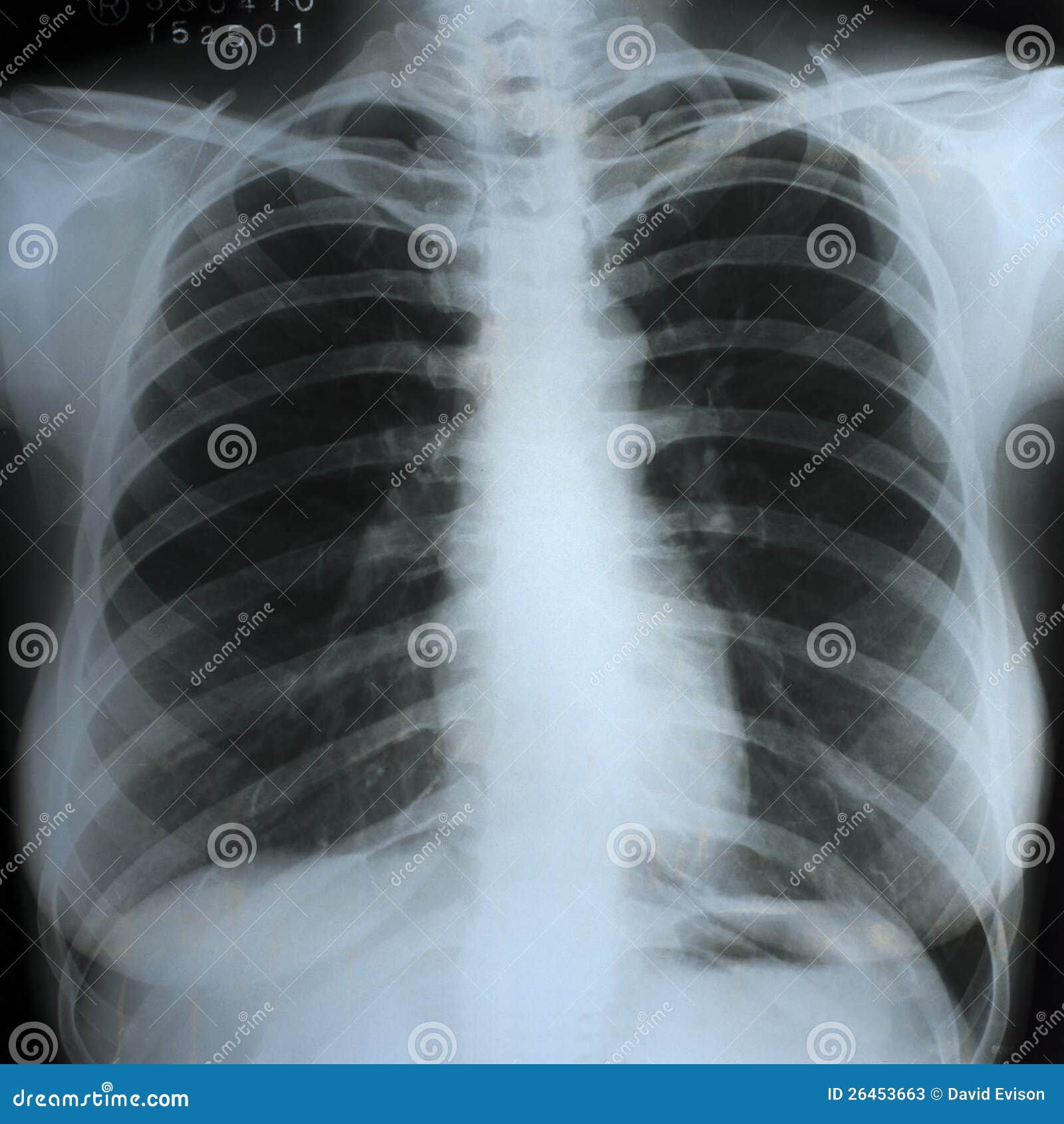A chest xray scan stock image. Image of abstract, chest - 26453663