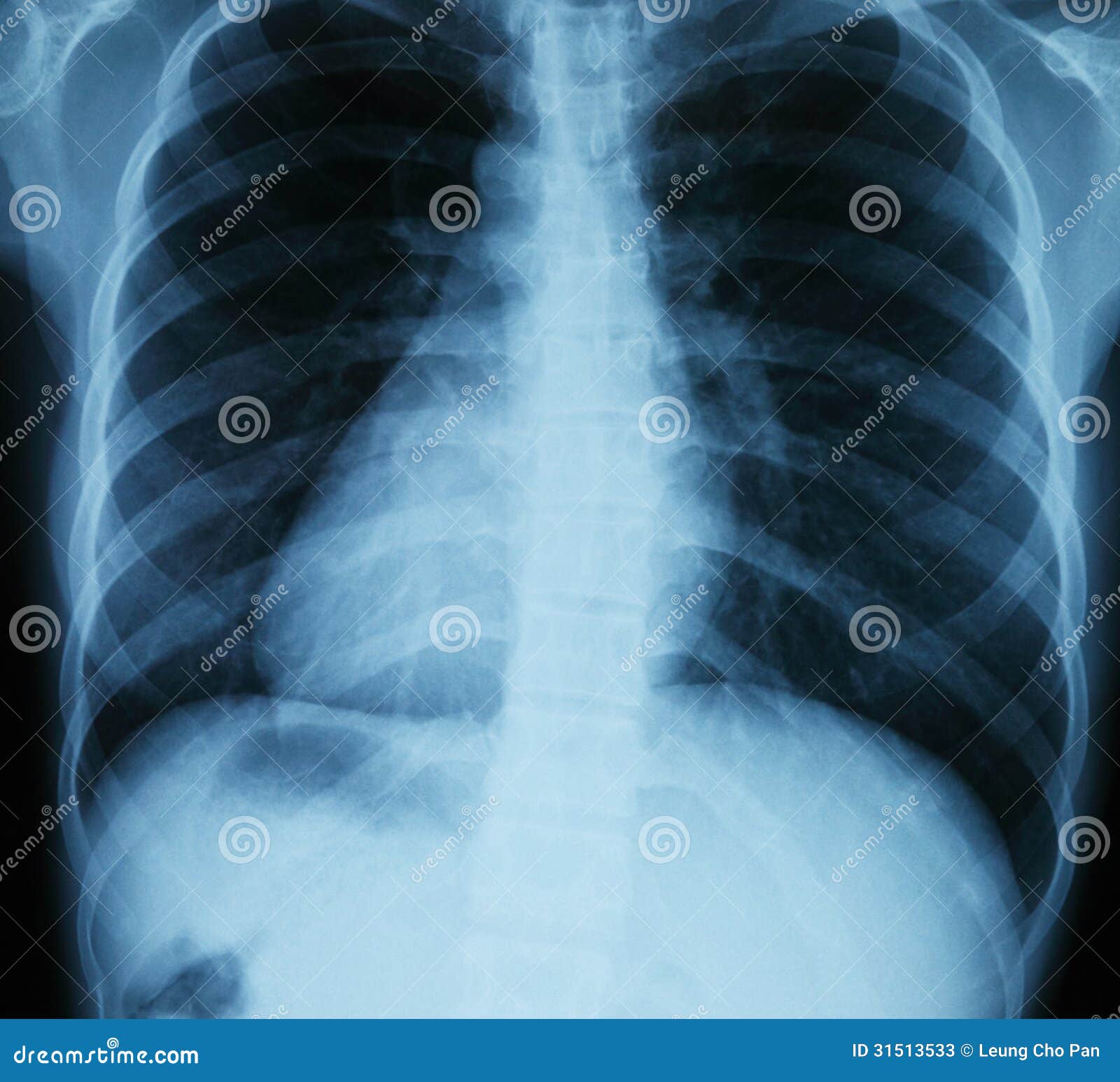 Chest xray scan stock image. Image of spine, hospital - 31513533