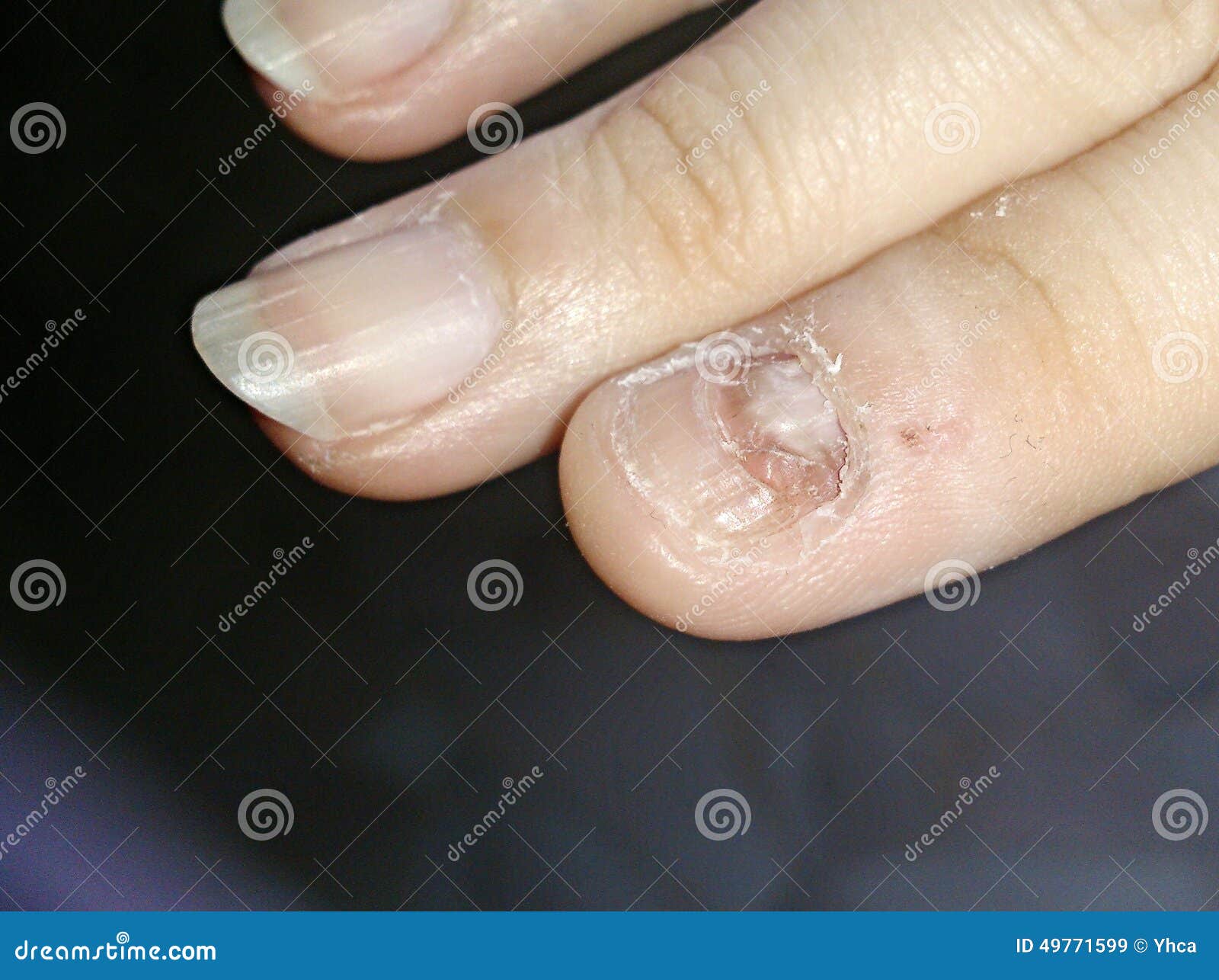 Chewed fingernail stock image. Image of chewed, compare - 49771599
