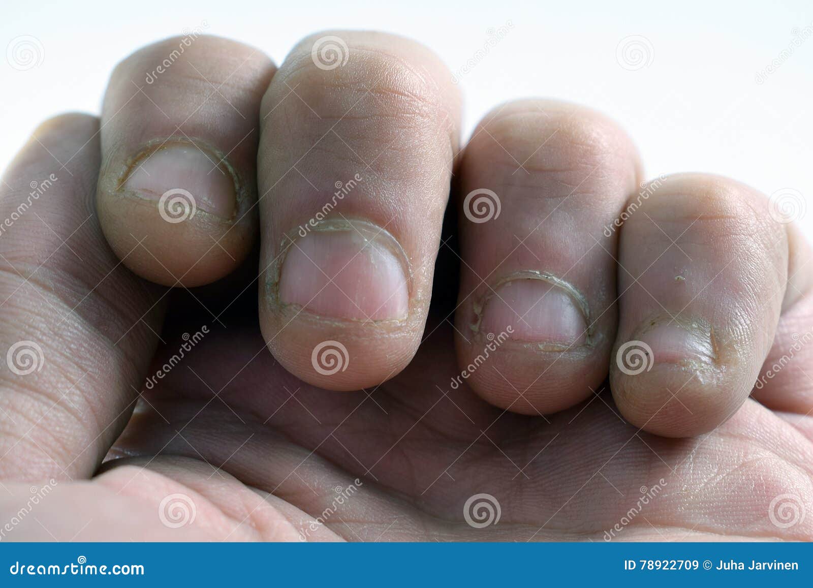 Chewed fingernails stock image. Image of biter, chew - 78922709
