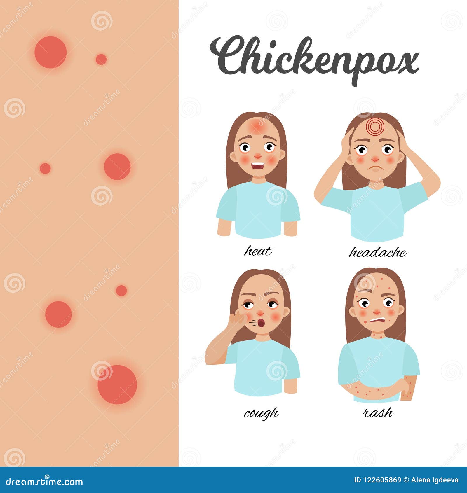 Chicckenpox infographic stock vector. Illustration of character - 122605869