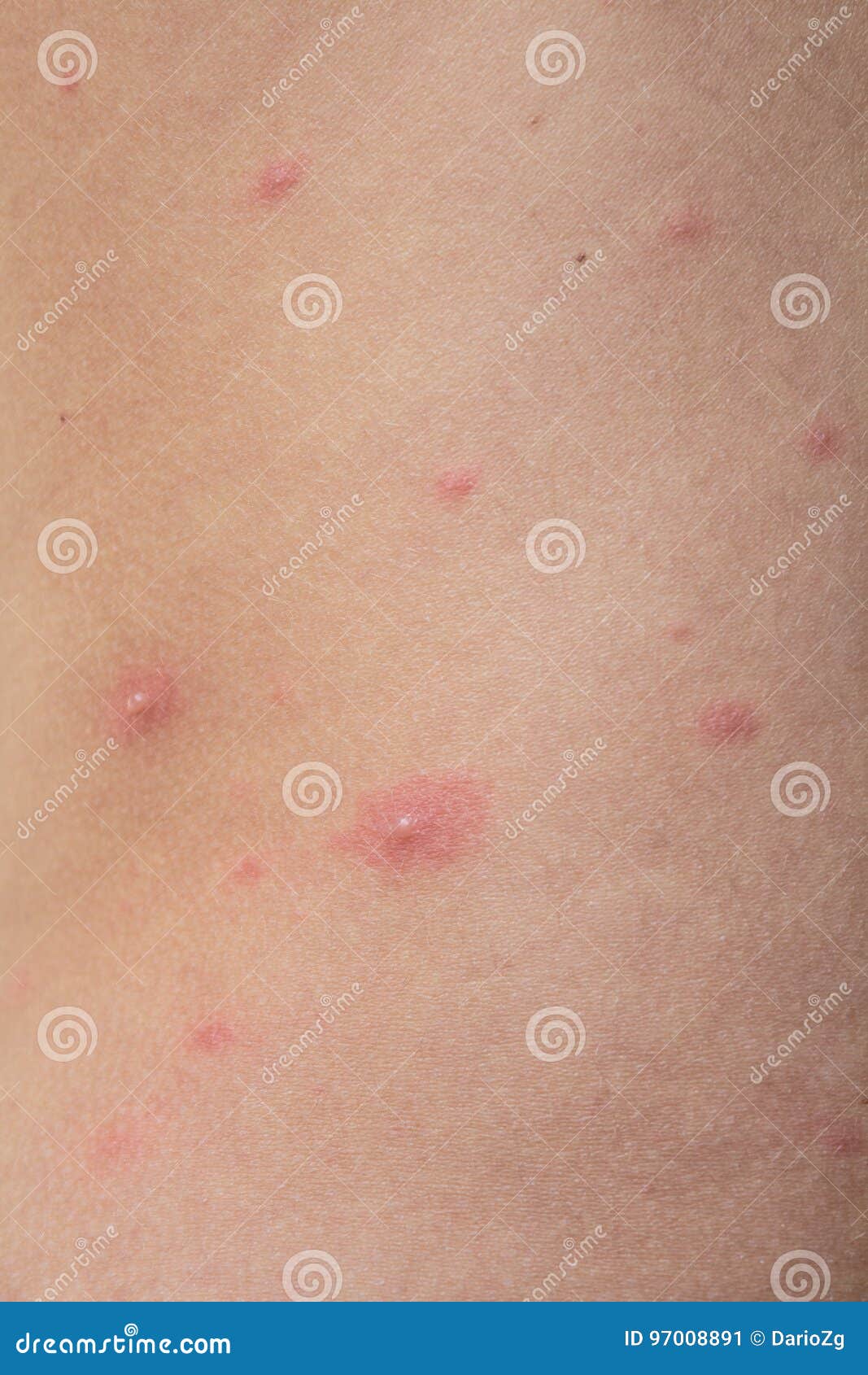 Chicken pox stock image. Image of health, itch, rash - 97008891