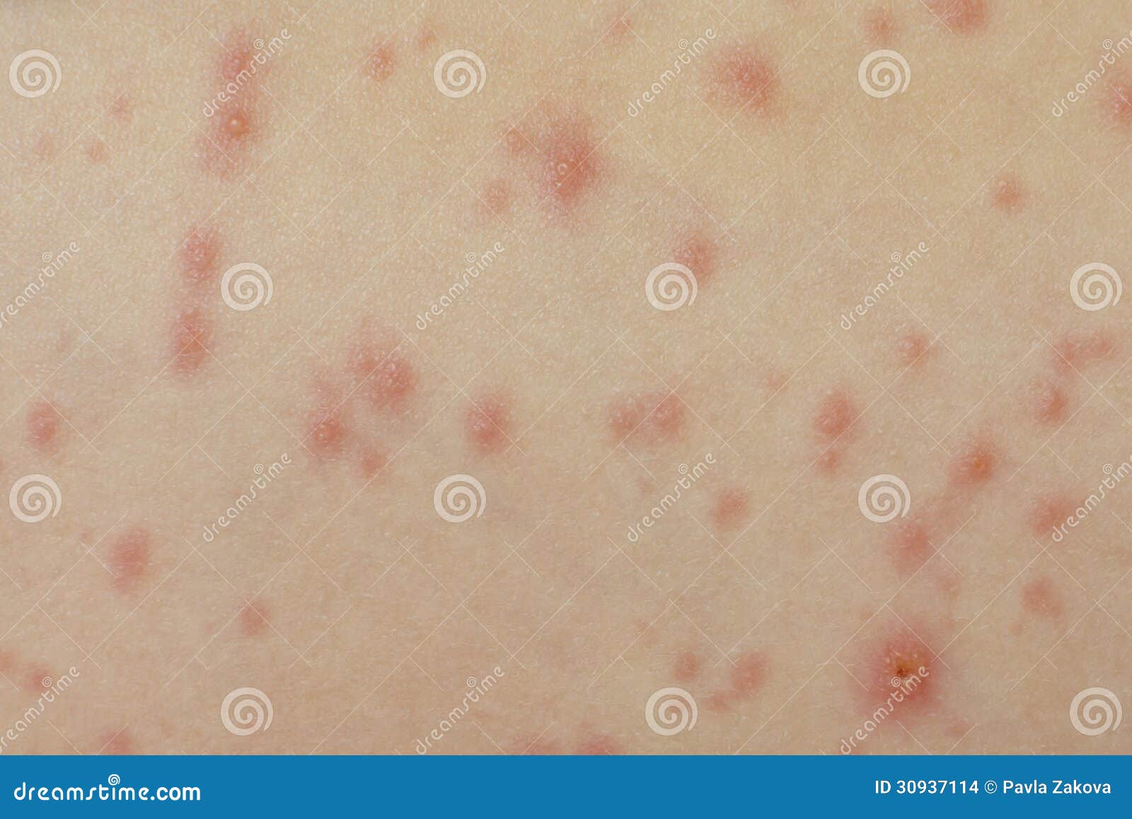 Chicken pox stock photo. Image of illness, symptoms, healthcare - 30937114