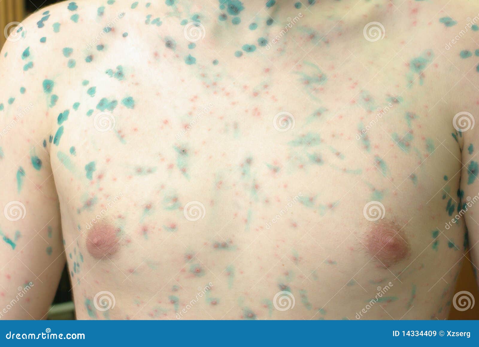 Chicken-pox patient stock image. Image of rash, illness - 14334409