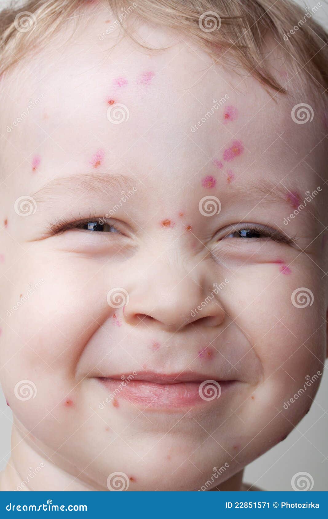 Chickenpox stock image. Image of virus, emotion, illness - 22851571
