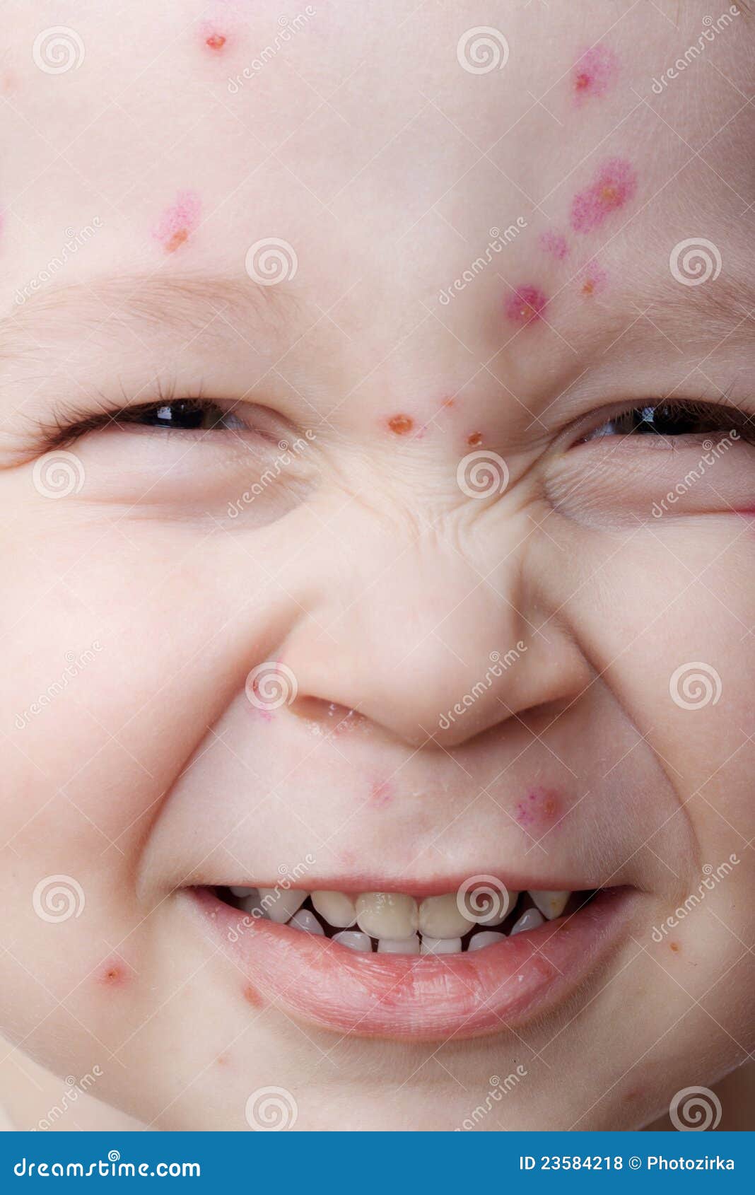 Chickenpox stock photo. Image of emotion, portrait, indoor - 23584218