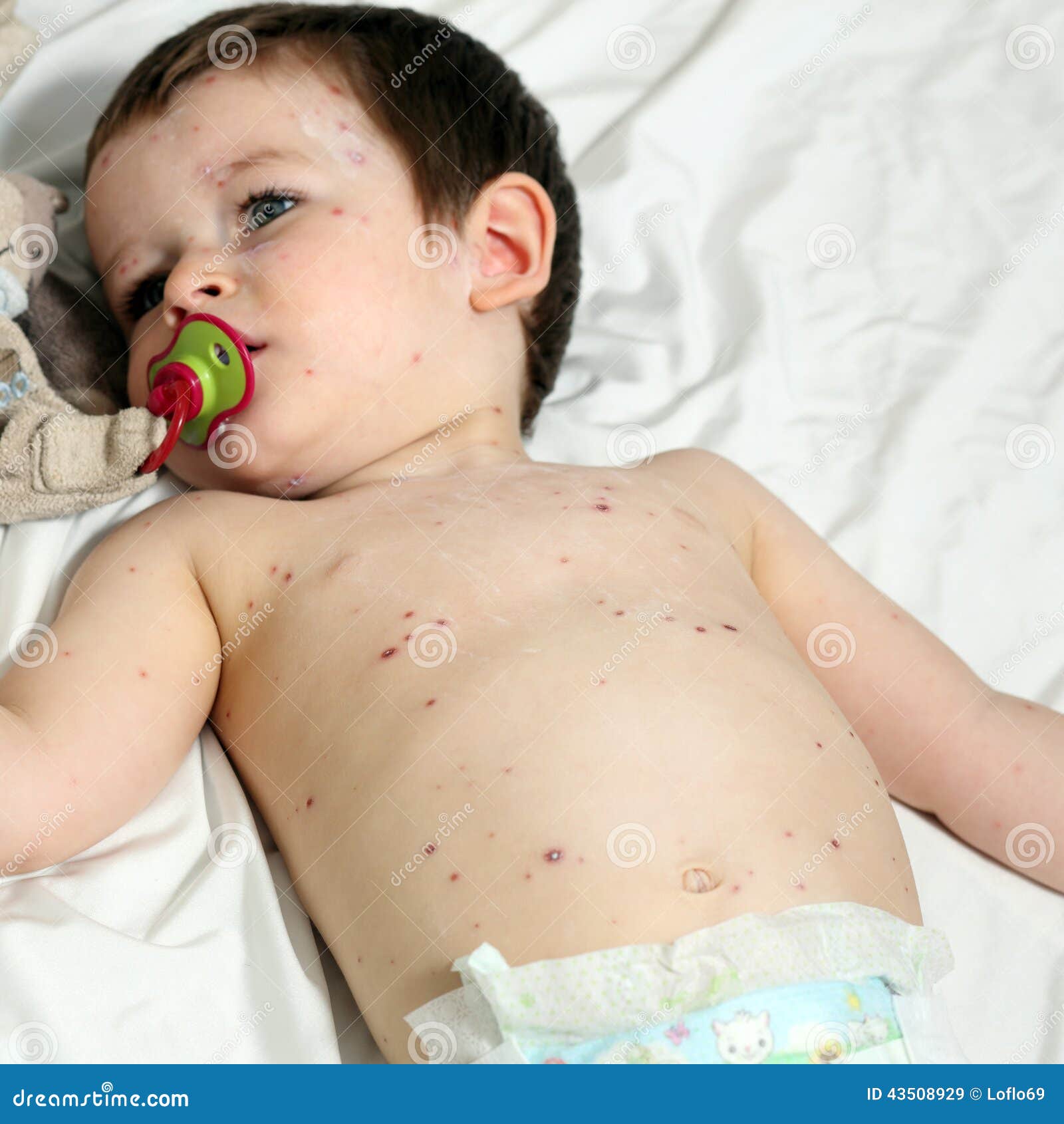 Chickenpox and baby stock image. Image of belly, disease - 43508929