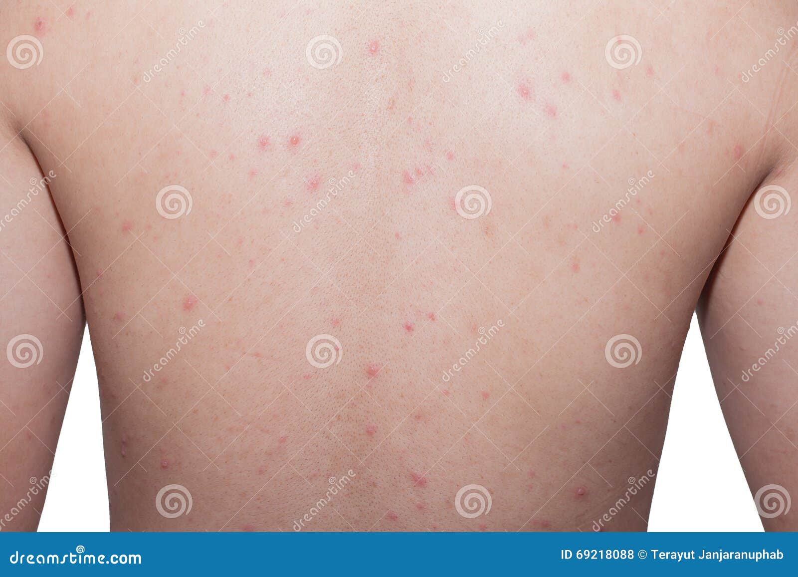 Chickenpox back view. stock photo. Image of disease, body - 69218088