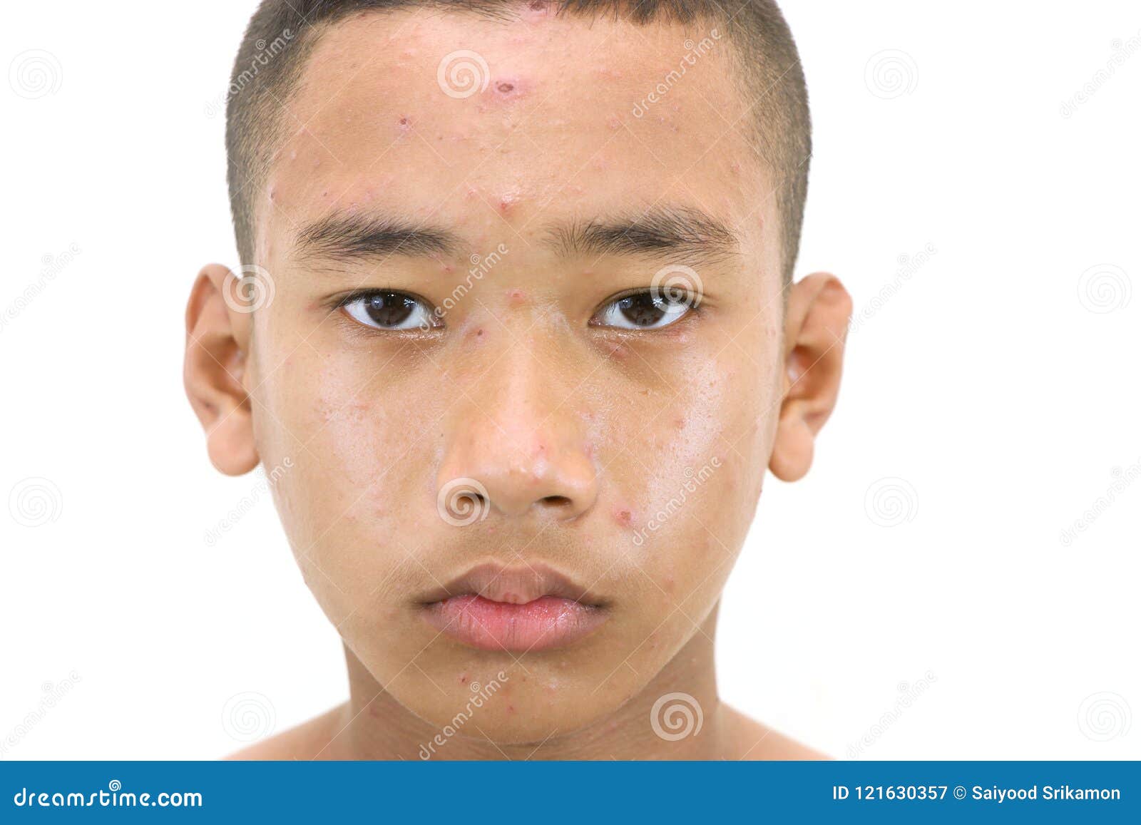 Chickenpox Bubble Rash on a Boy. Stock Image - Image of neck, rash ...
