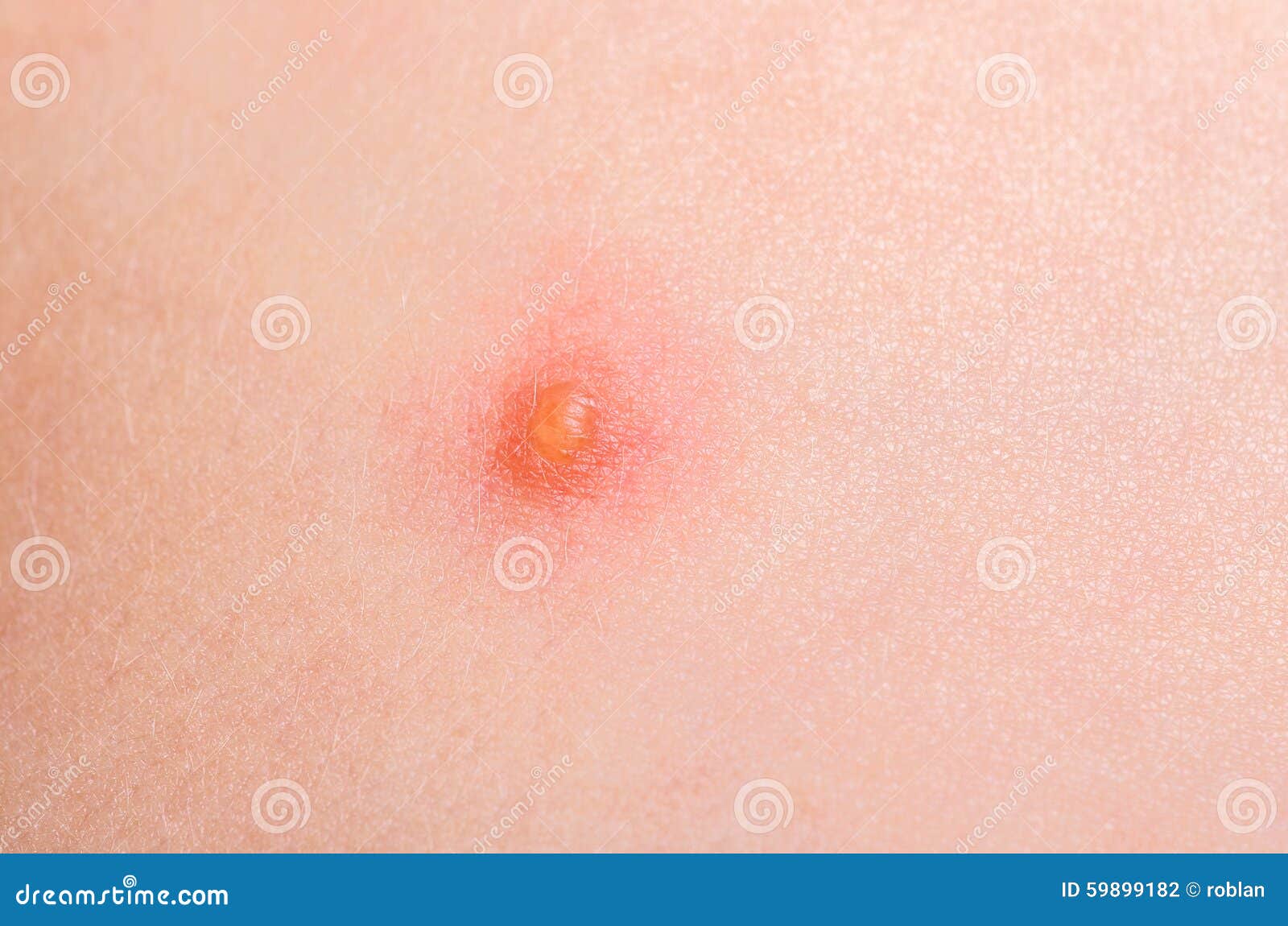 Chickenpox stock photo. Image of baby, bacterial, reaction - 59899182