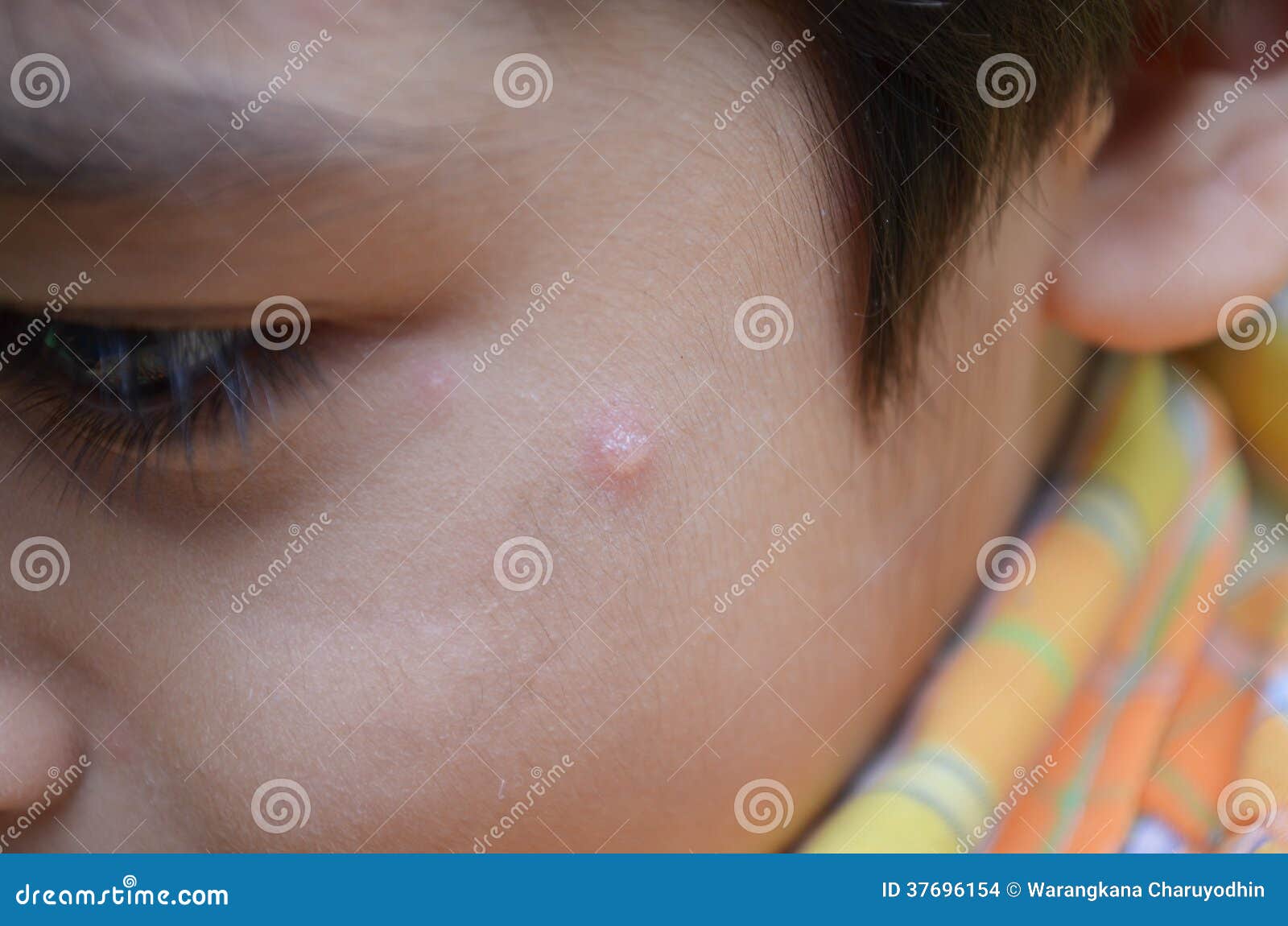 Chickenpox on the face stock photo. Image of itch, contagious - 37696154