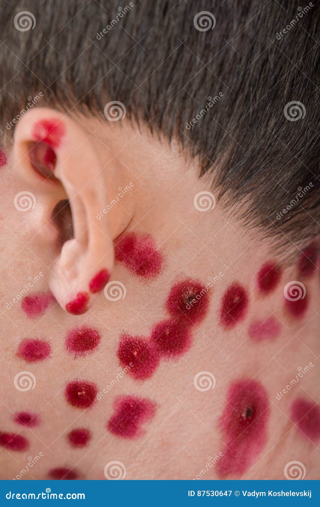 Chickenpox on face stock image. Image of dermatology - 87530647