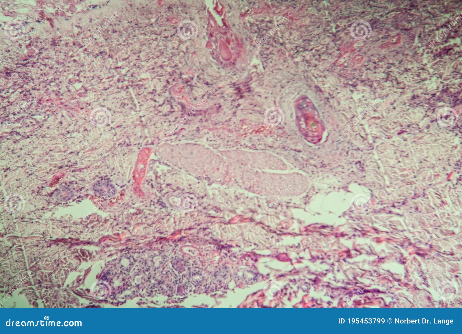 Chickenpox Infection Tissue Under the Microscope Stock Image - Image of ...