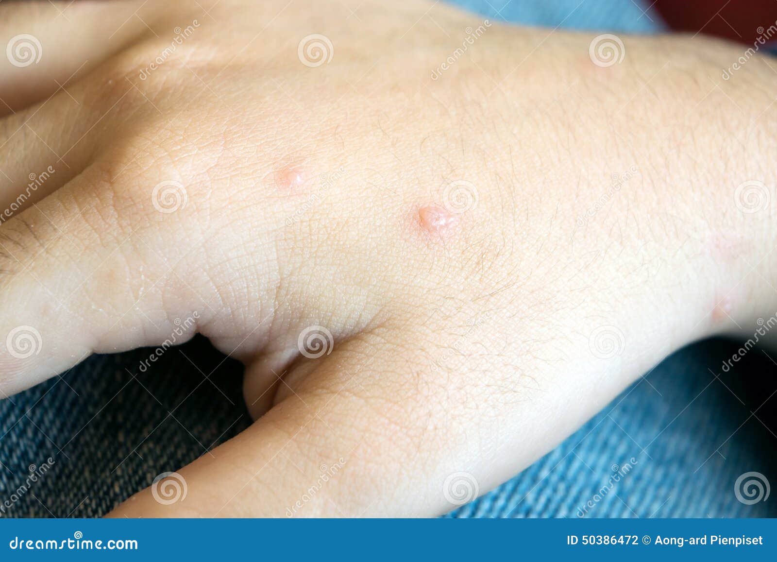 Chickenpox on Little Boy Hand Stock Photo - Image of child, immune ...