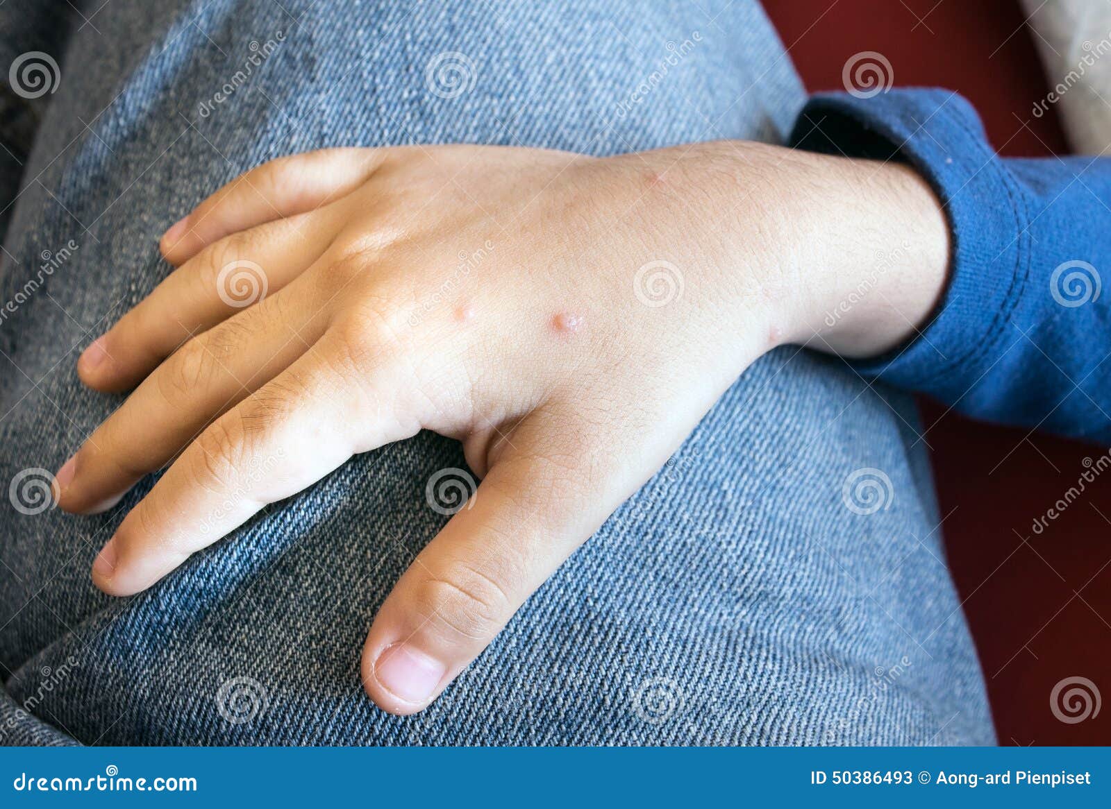Chickenpox on Little Boy Hand Stock Image - Image of good, hand: 50386493