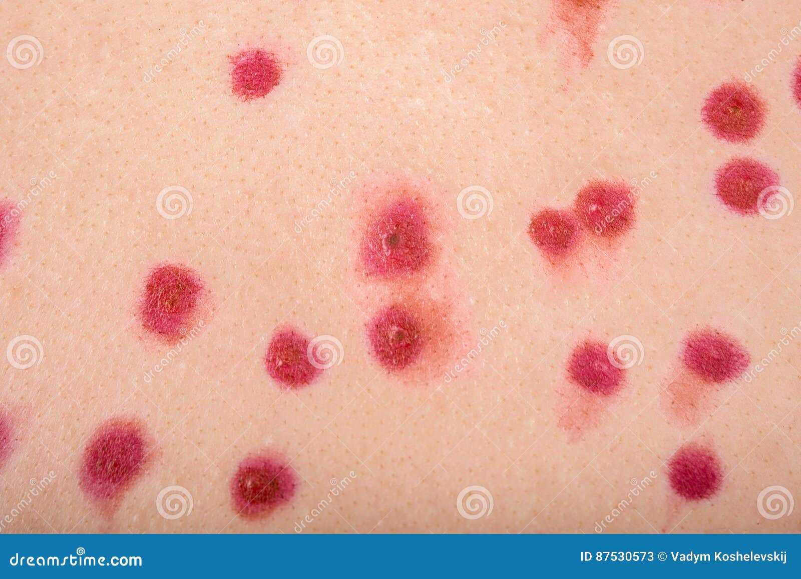 Chickenpox Rash. Shingles, Varicella-zoster Virus. Skin Rash And ...