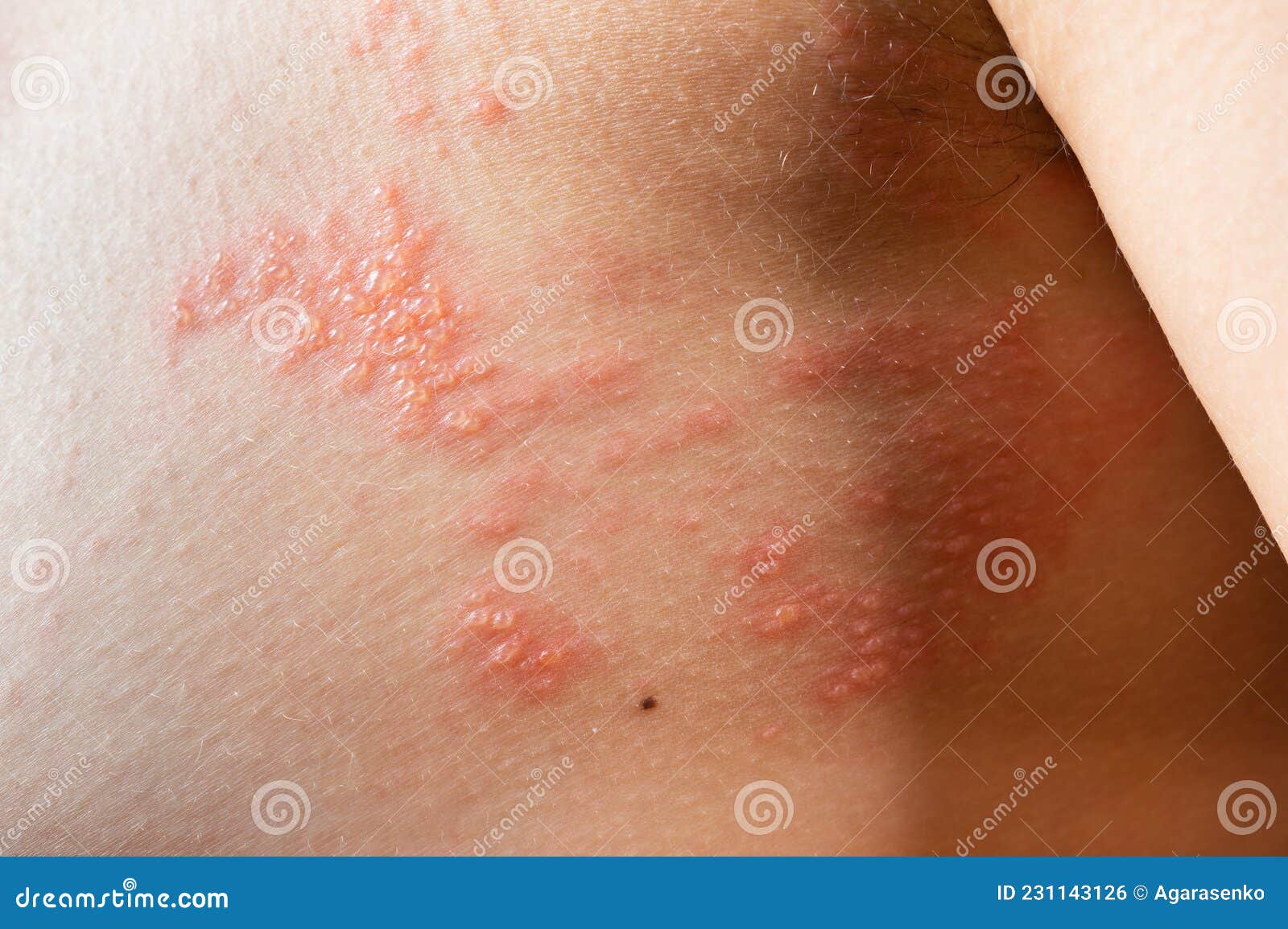 Chickenpox Rash Shingles Varicella Zoster Virus Skin Rash And Blisters On Body Skin Infected