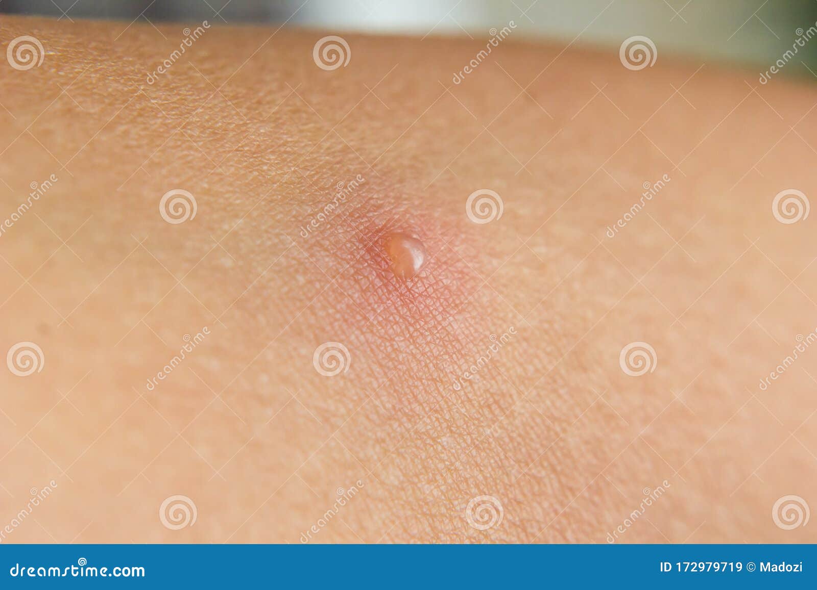 Chickenpox Varicella on the Skin Stock Image - Image of background ...