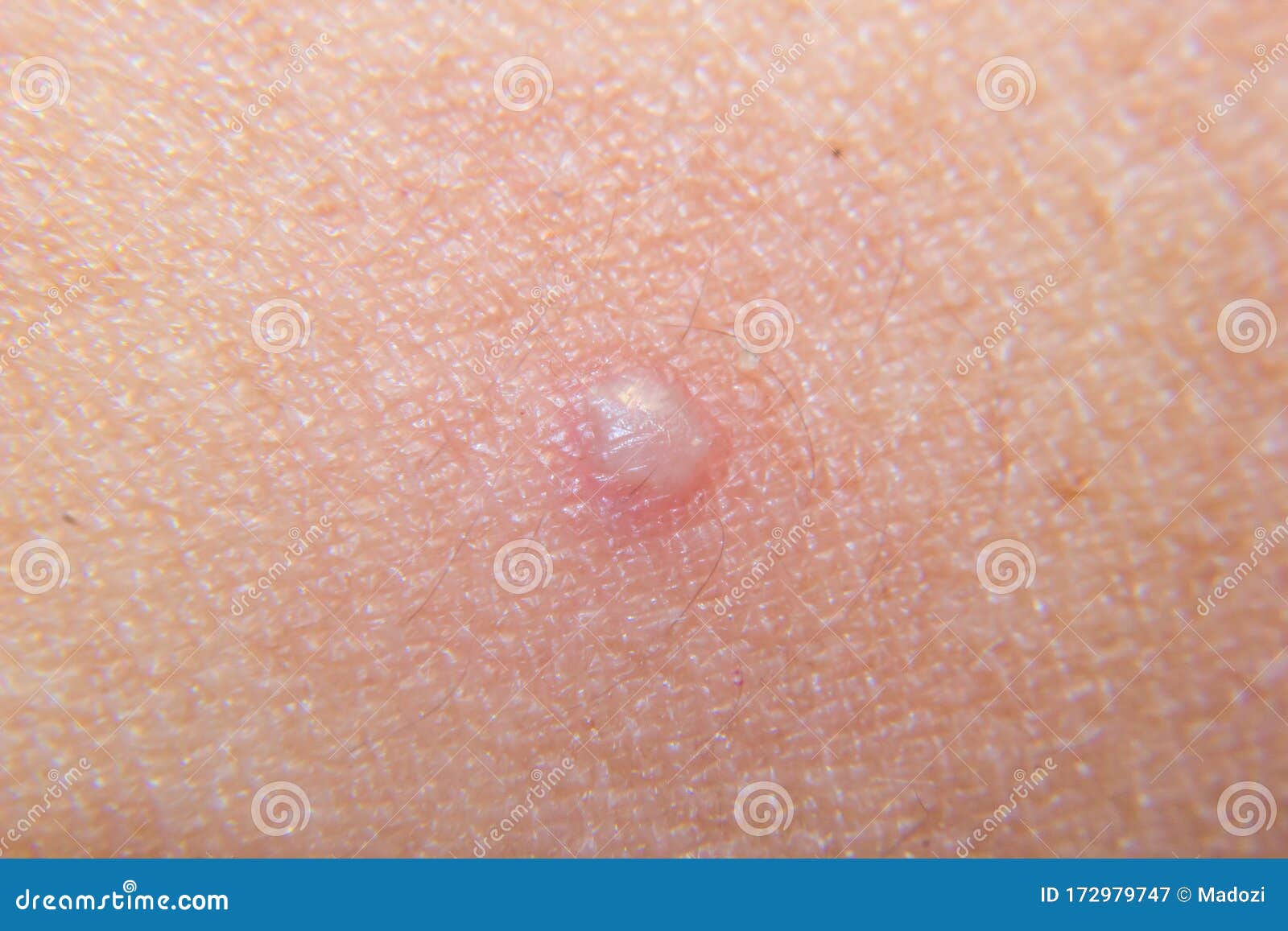 Chickenpox Varicella on the Skin Stock Image - Image of varicella ...