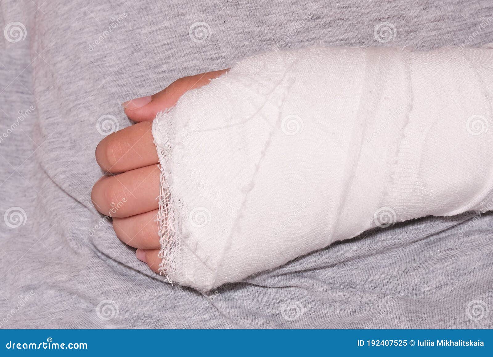 A Child Broken Arm in Plaster Case, Hand Injury because of Accident ... A Child Broken Arm in Plaster Case, Hand Injury because of Accident ...