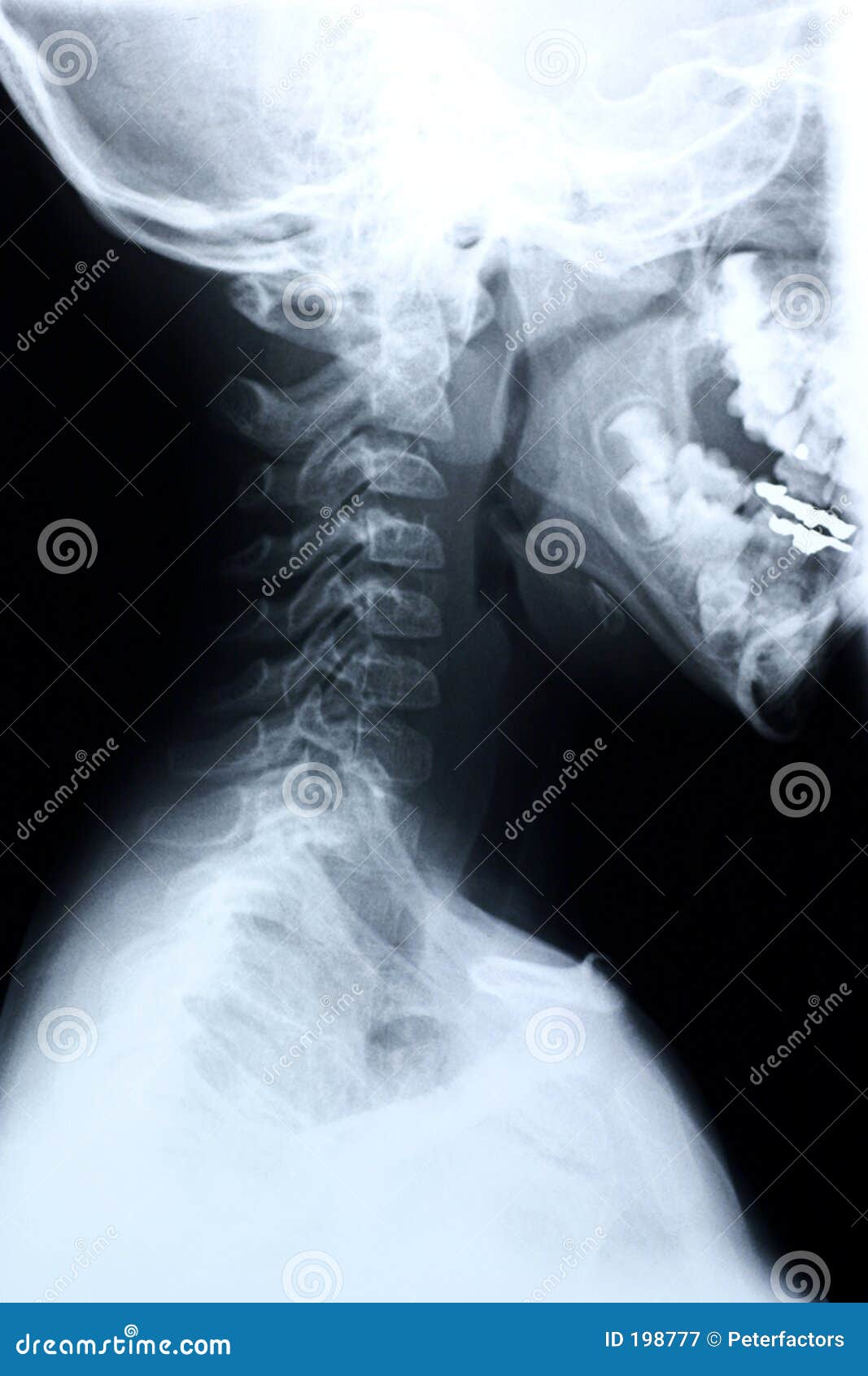 Child Cervical Spine/side View Stock Image - Image of medicine, nurse ...