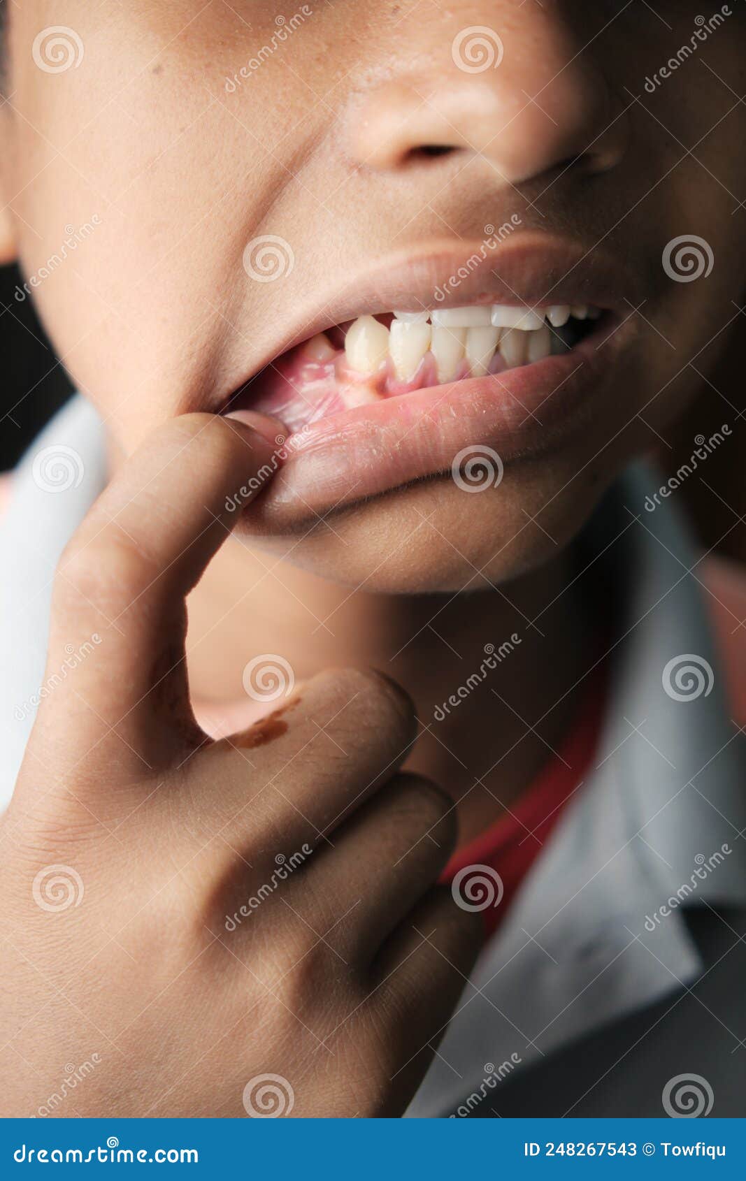 Child with Deformed Teeth Close Up Stock Image - Image of white ...