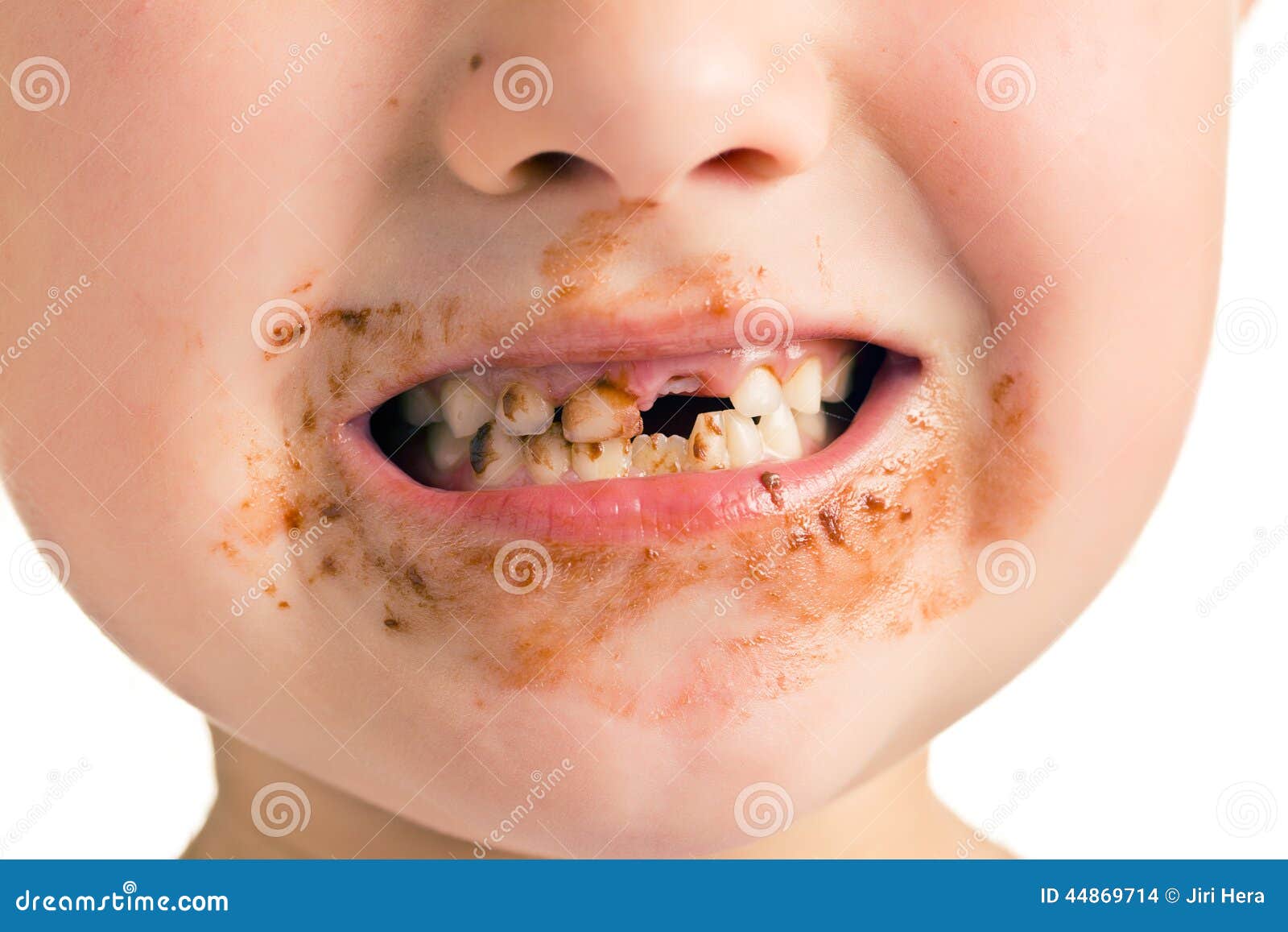 Child with a Dirty Mouth and Missing Tooth Stock Photo - Image of human ...
