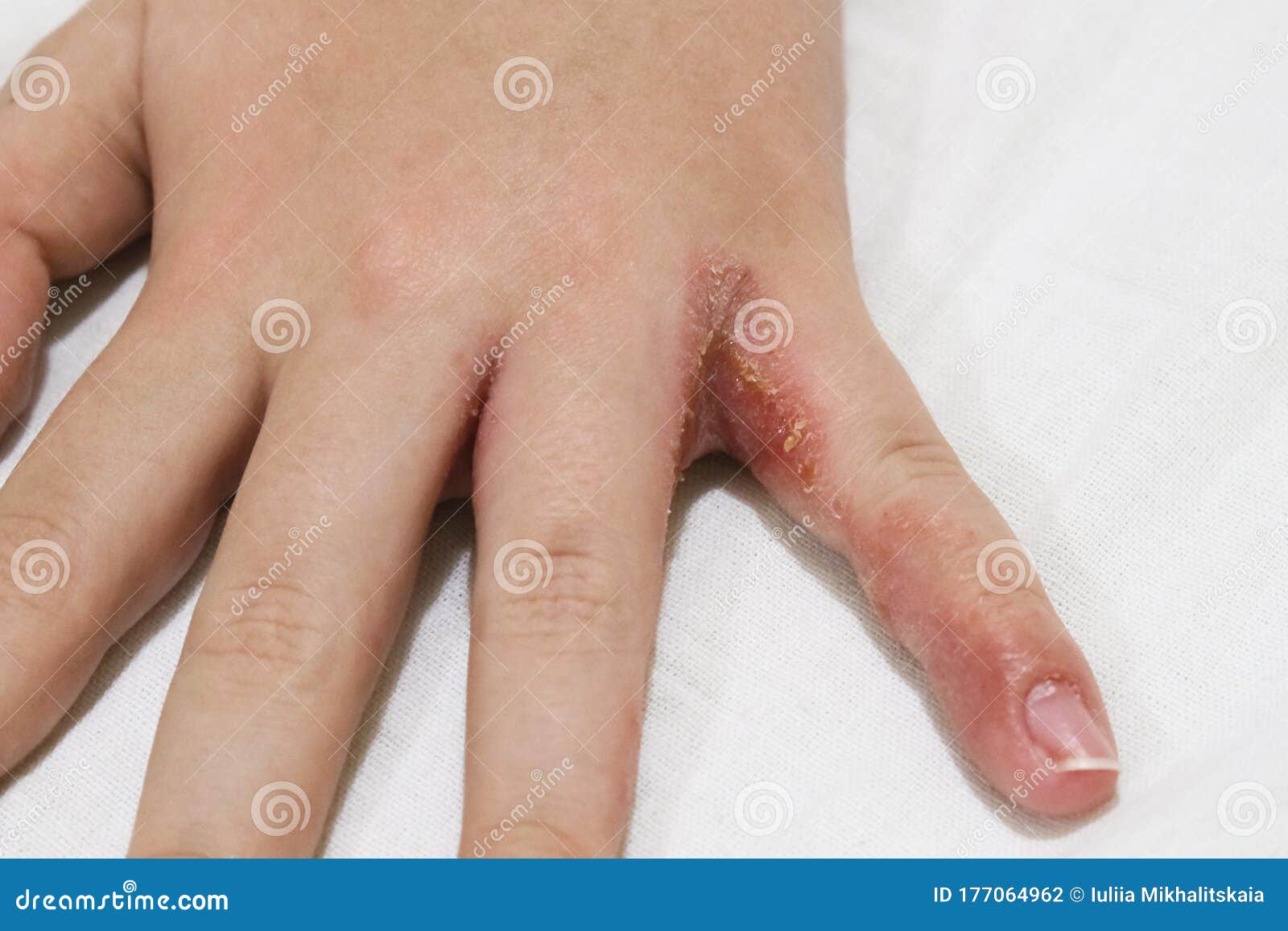 Child Hand Witn Eczema, Atopic Dermatitis between Fingers Stock Photo ...