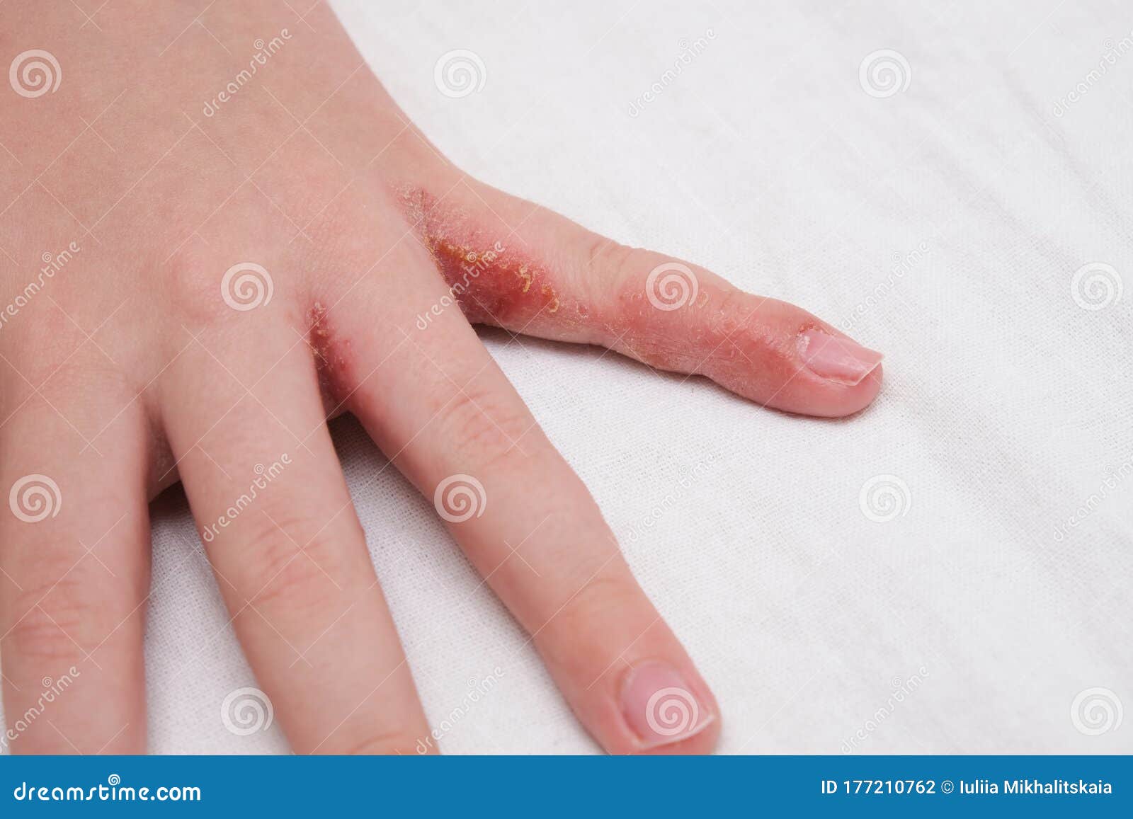 Child Hand Witn Eczema, Atopic Dermatitis between Fingers Stock Photo ...