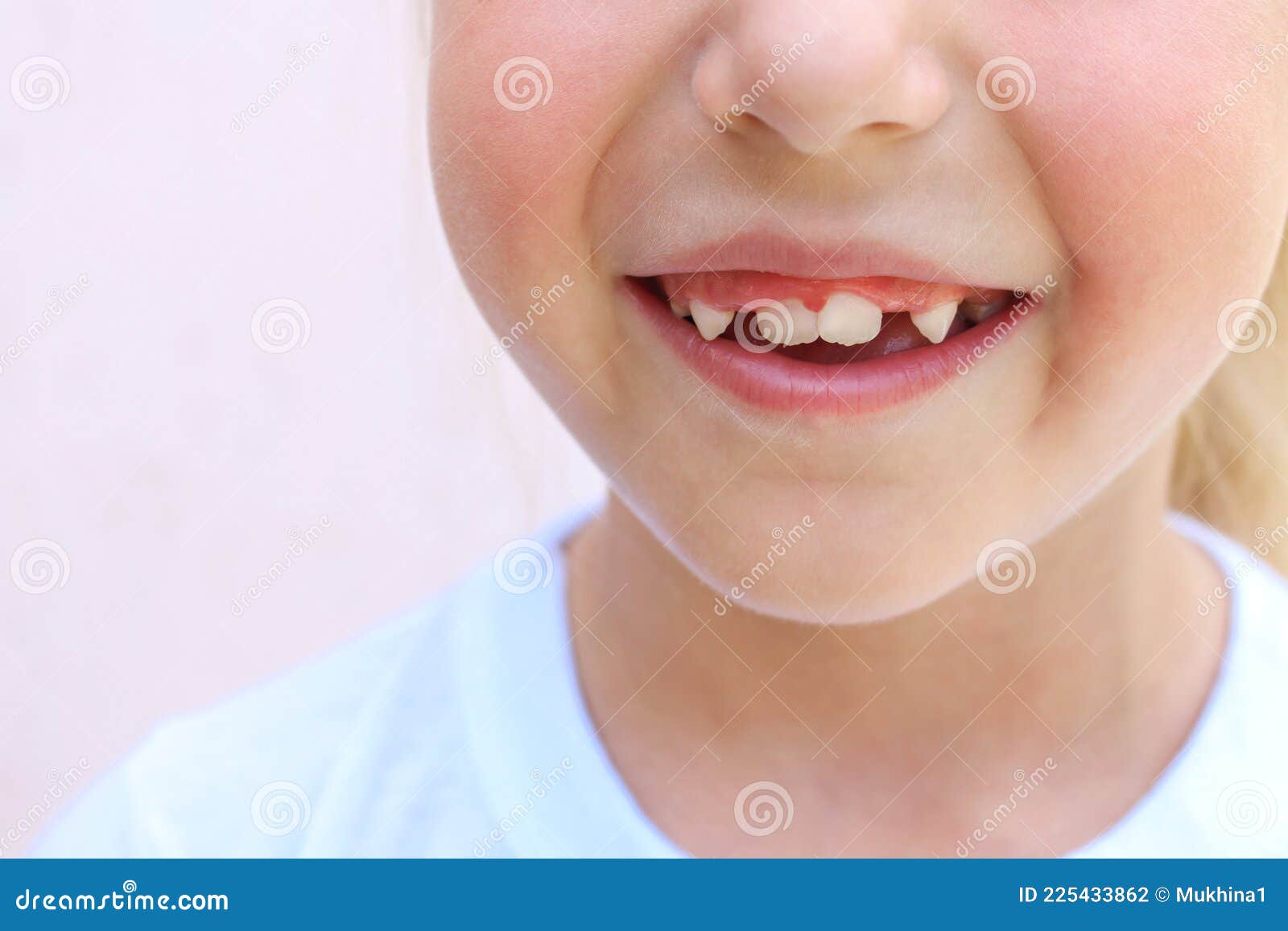Child Has Crooked Teeth. Baby Teeth Fell Out Stock Photo - Image of ...