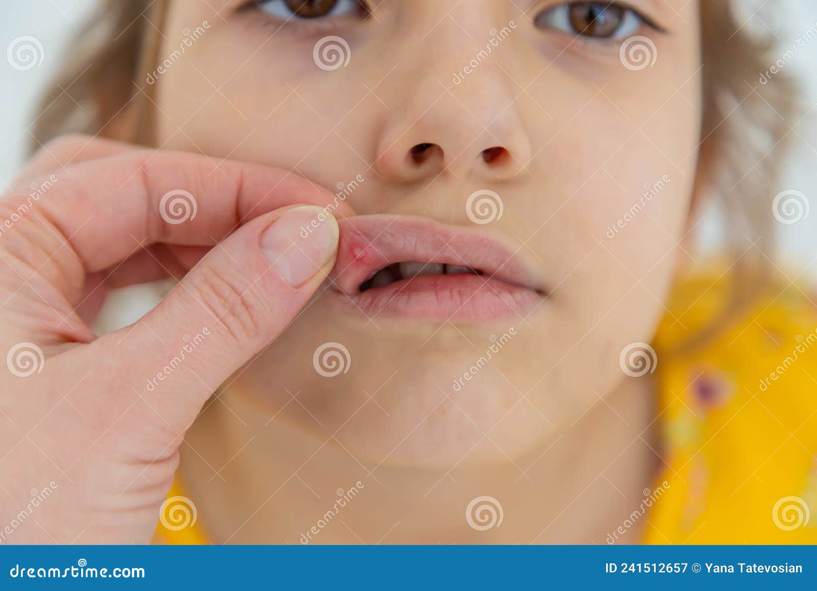 The Child Has Stomatitis on the Lip. Selective Focus Stock Image ...